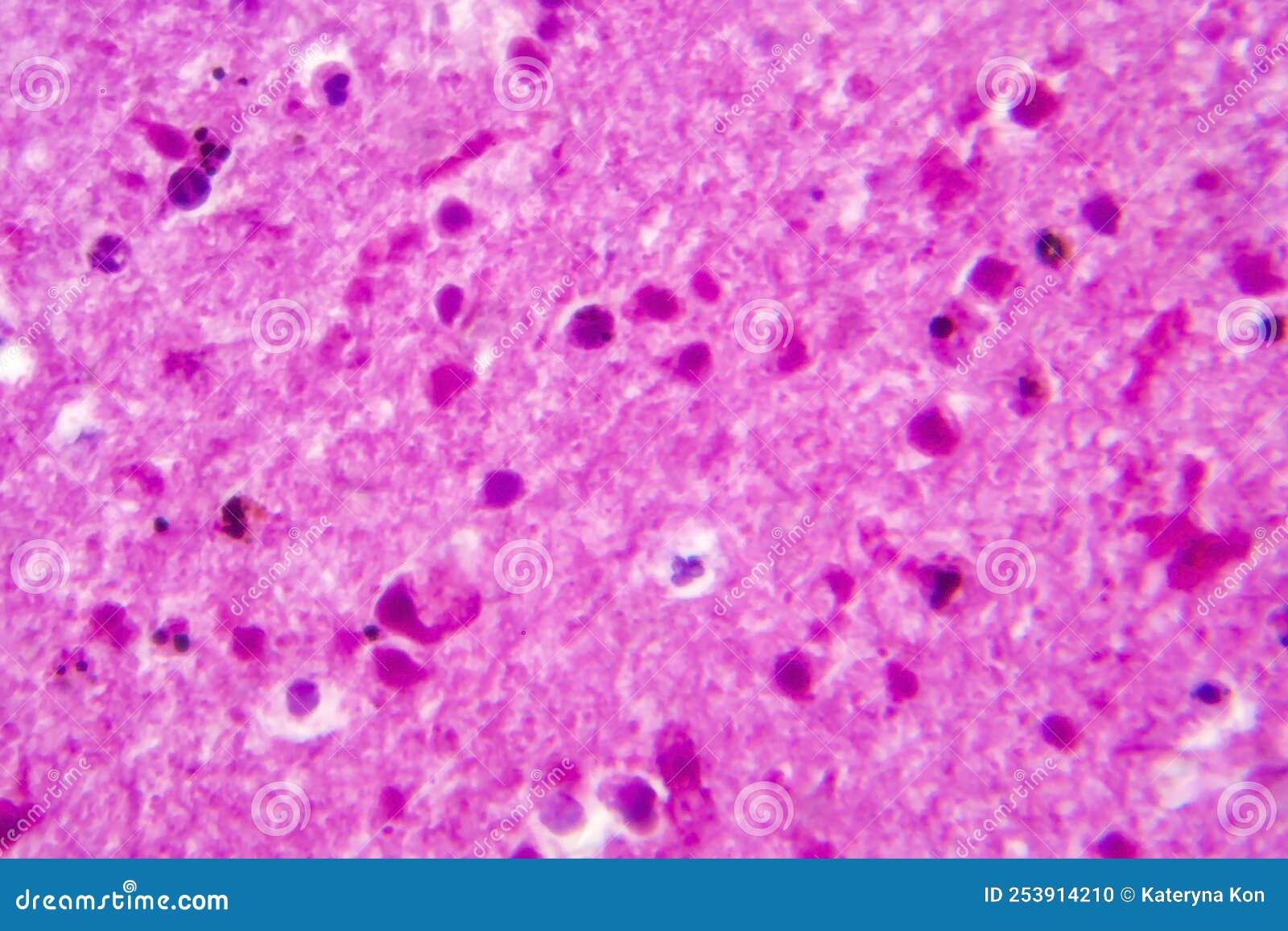 Purulent Meningitis, Light Micrograph Stock Photo - Image of ...