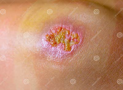 Purulent wound stock image. Image of injury, infection - 41100841