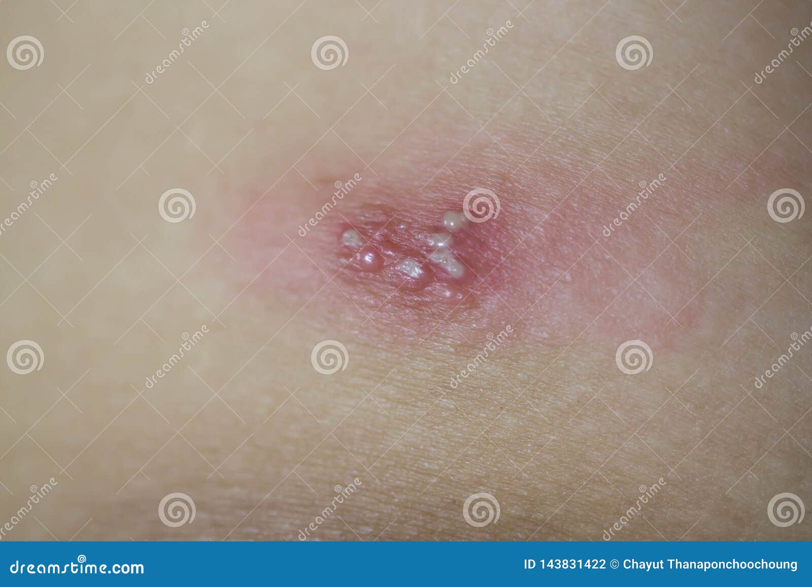 Pus stock photo. Image of skin, blood, abscess, close - 143831422