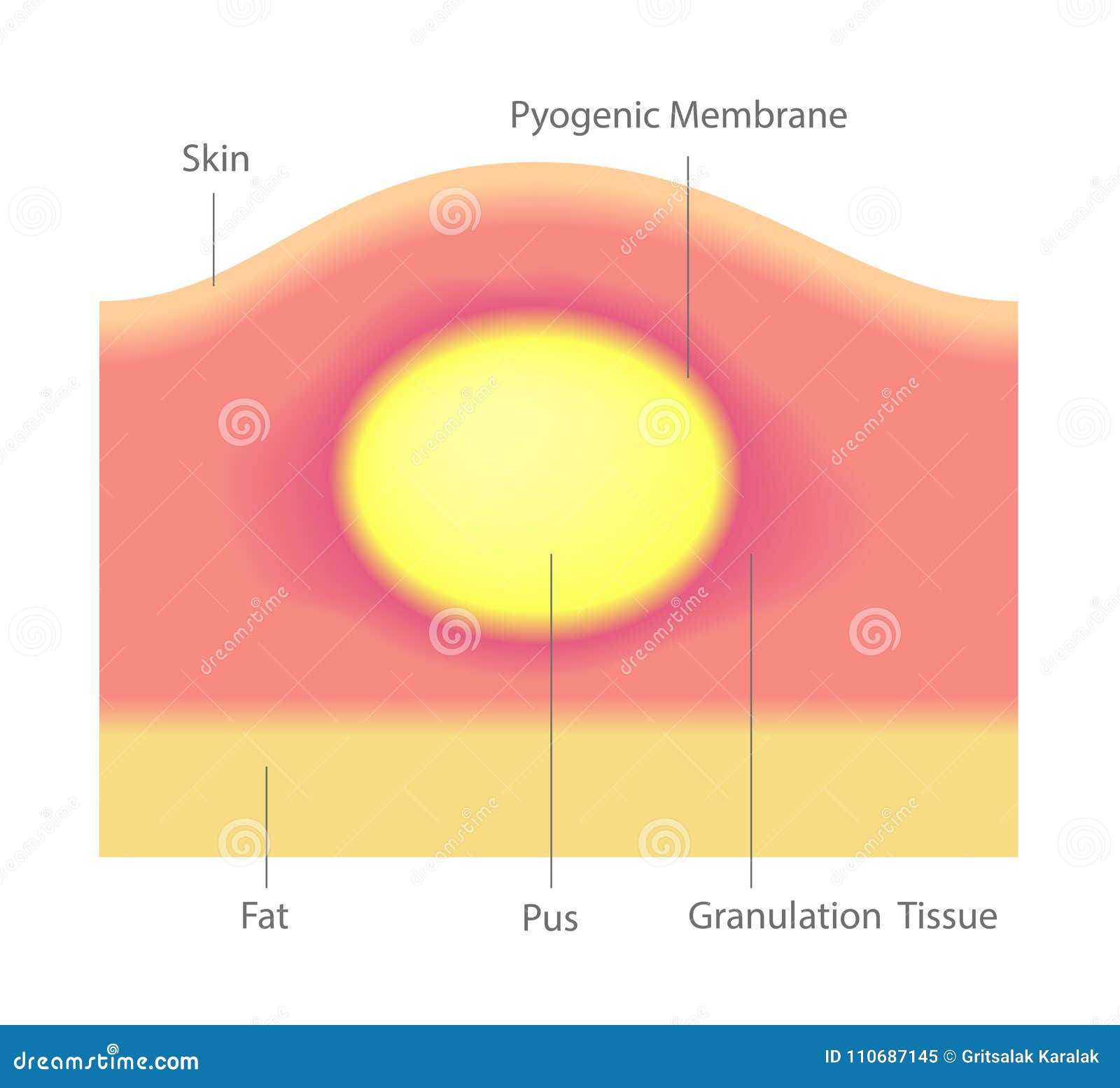 Pus Ilustraciones Stock, Vectores, Y Clipart – (592 Ilustraciones Stock)