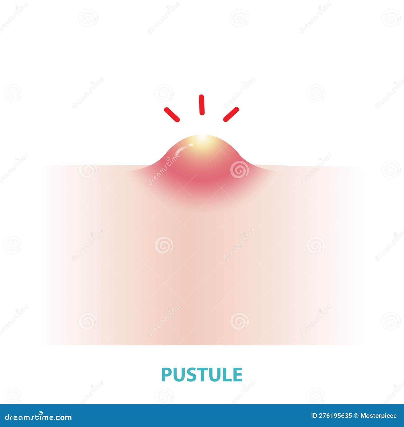Pustule