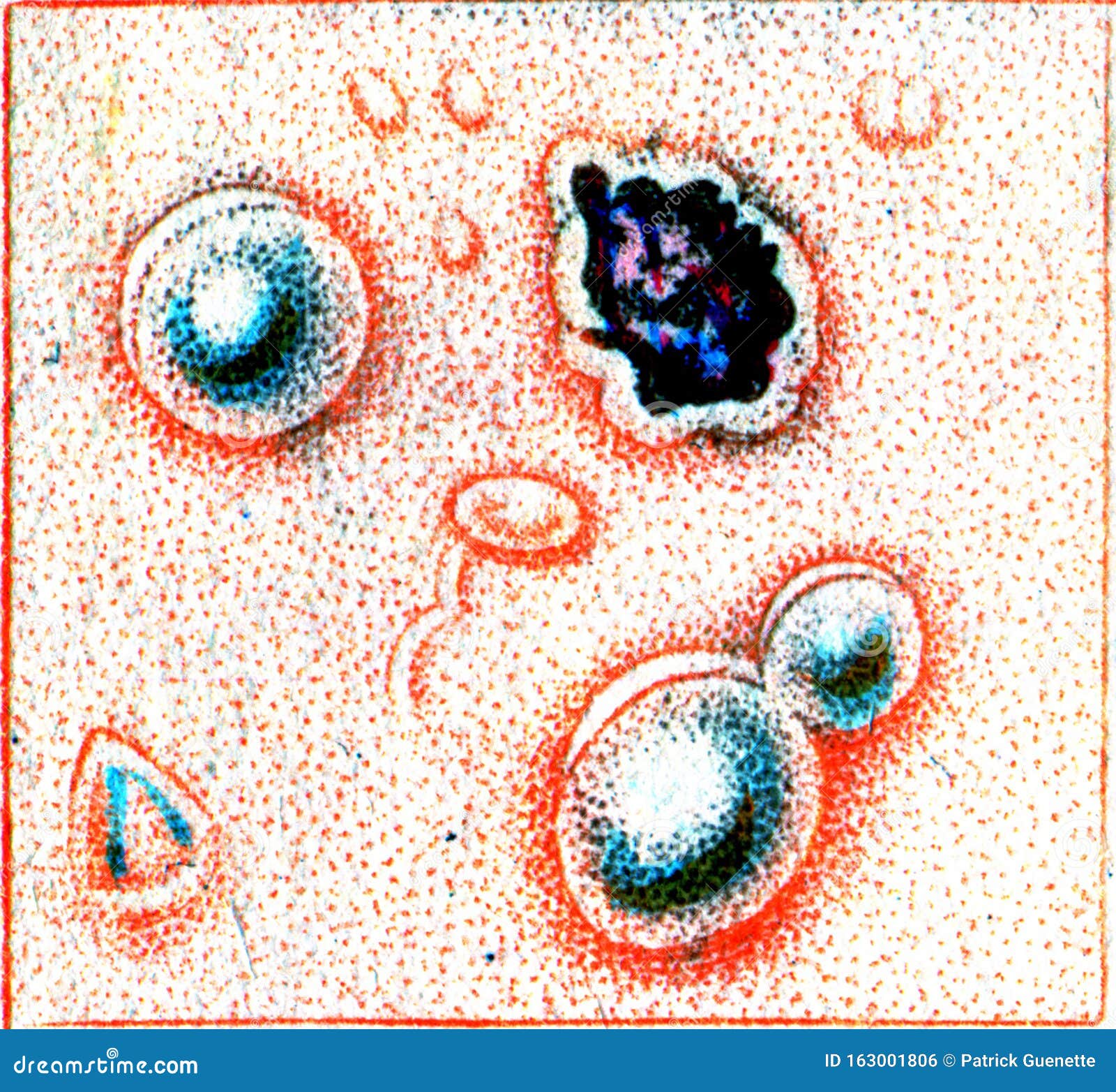 Pustules of Scabies, Vintage Engraving Stock Illustration ...