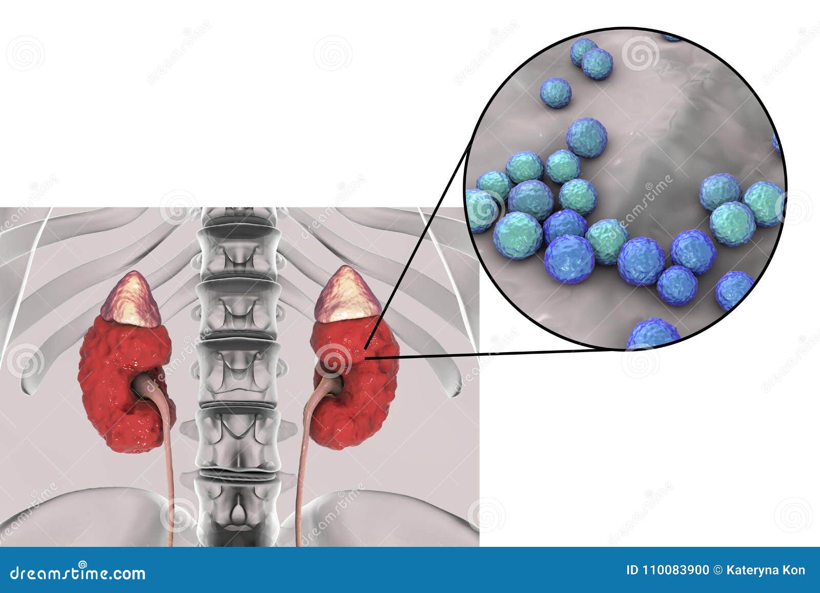 Pyelonephritis Caused by Bacteria Enterococcus Stock Illustration ...