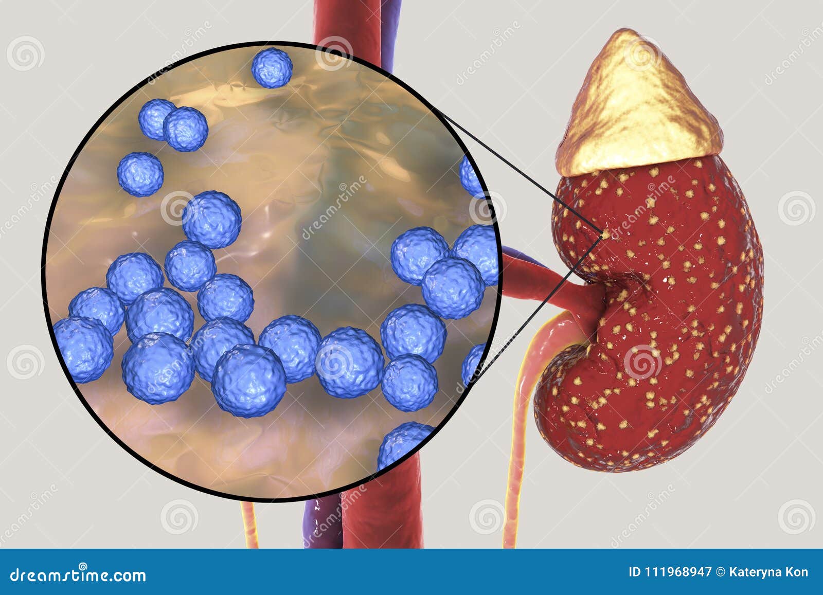 Pyelonephritis, Medical Concept, and Close-up View of Bacteria, the ...