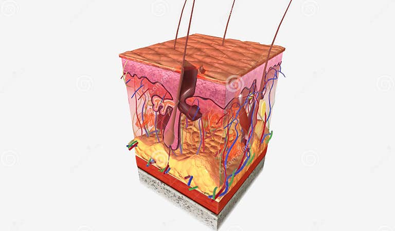 Pyoderma Gangrenosum Stage I 3d Stock Illustration - Illustration of ...