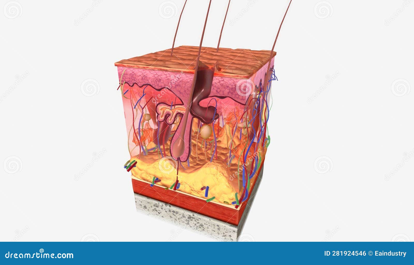 Pyoderma Gangrenosum Stage I 3d Stock Illustration - Illustration of ...