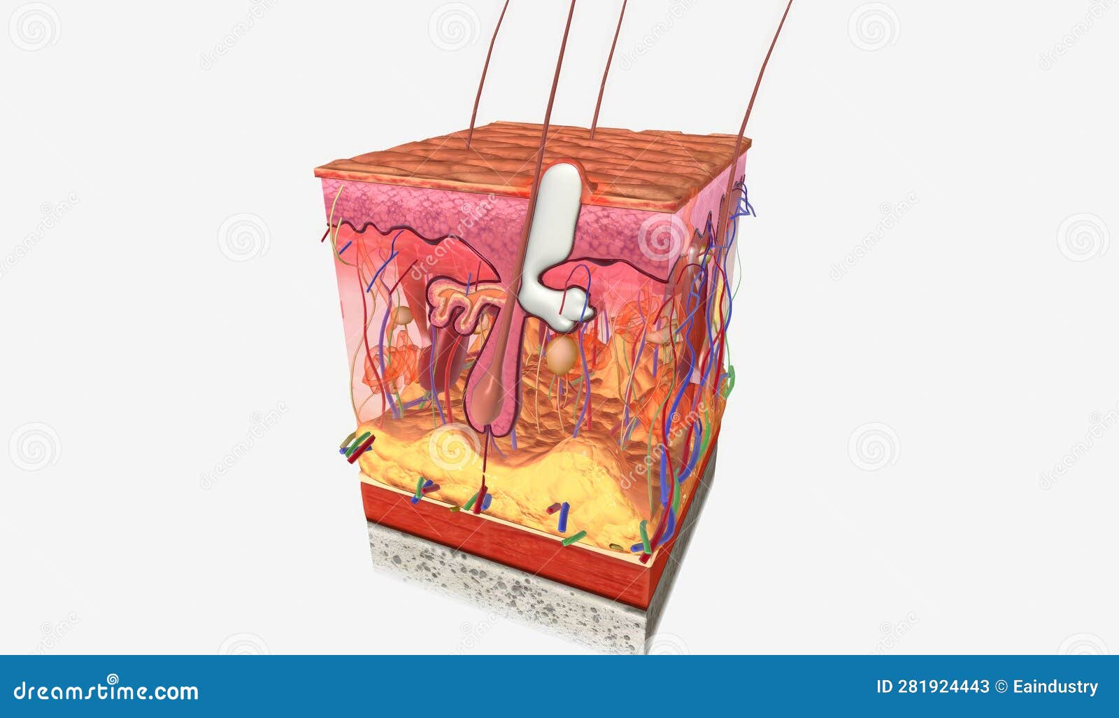 Pyoderma Gangrenosum Stage II 3d Stock Illustration - Illustration of ...