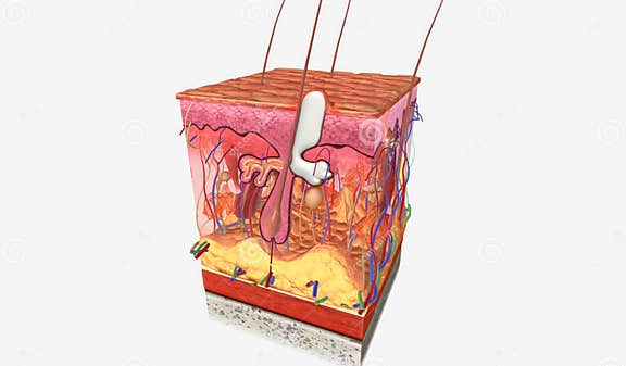 Pyoderma Gangrenosum Stage II 3d Stock Illustration - Illustration of ...
