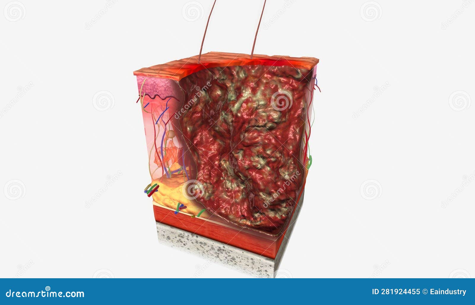 Pyoderma Gangrenosum Stage III3d Stock Illustration - Illustration of ...