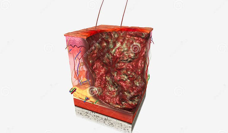 Pyoderma Gangrenosum Stage III3d Stock Illustration - Illustration of ...
