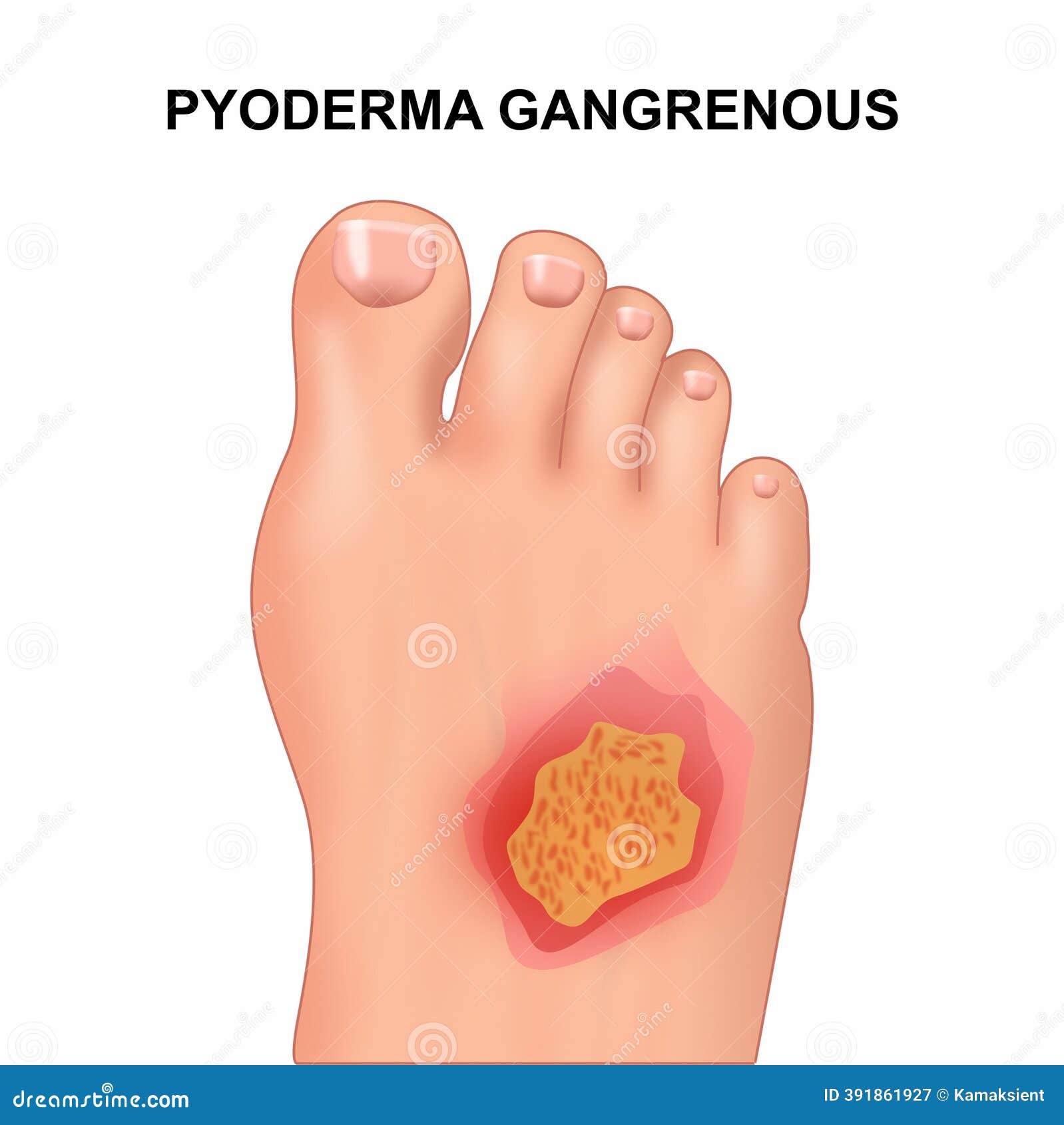 Gangrenous Cartoons, Illustrations & Vector Stock Images - 43 Pictures ...