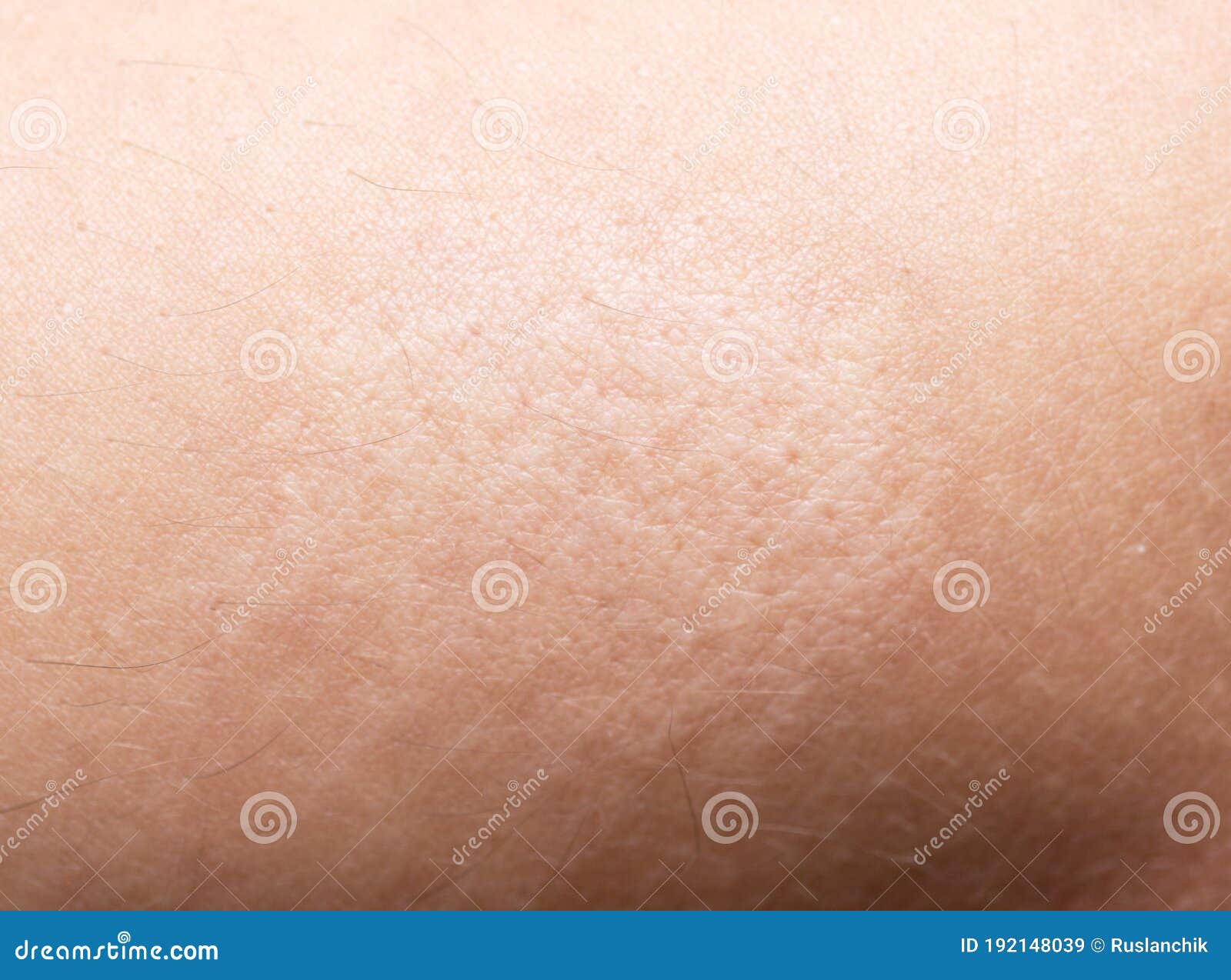 Queimadura na pele imagem de stock. Imagem de ajuda - 192148039