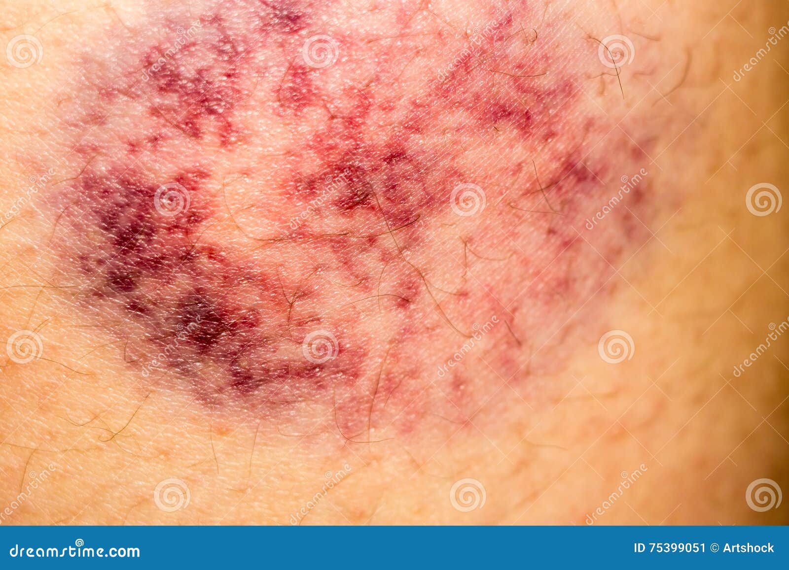 Quetschung auf Haut stockbild. Bild von purpurrot, nahaufnahme - 75399051