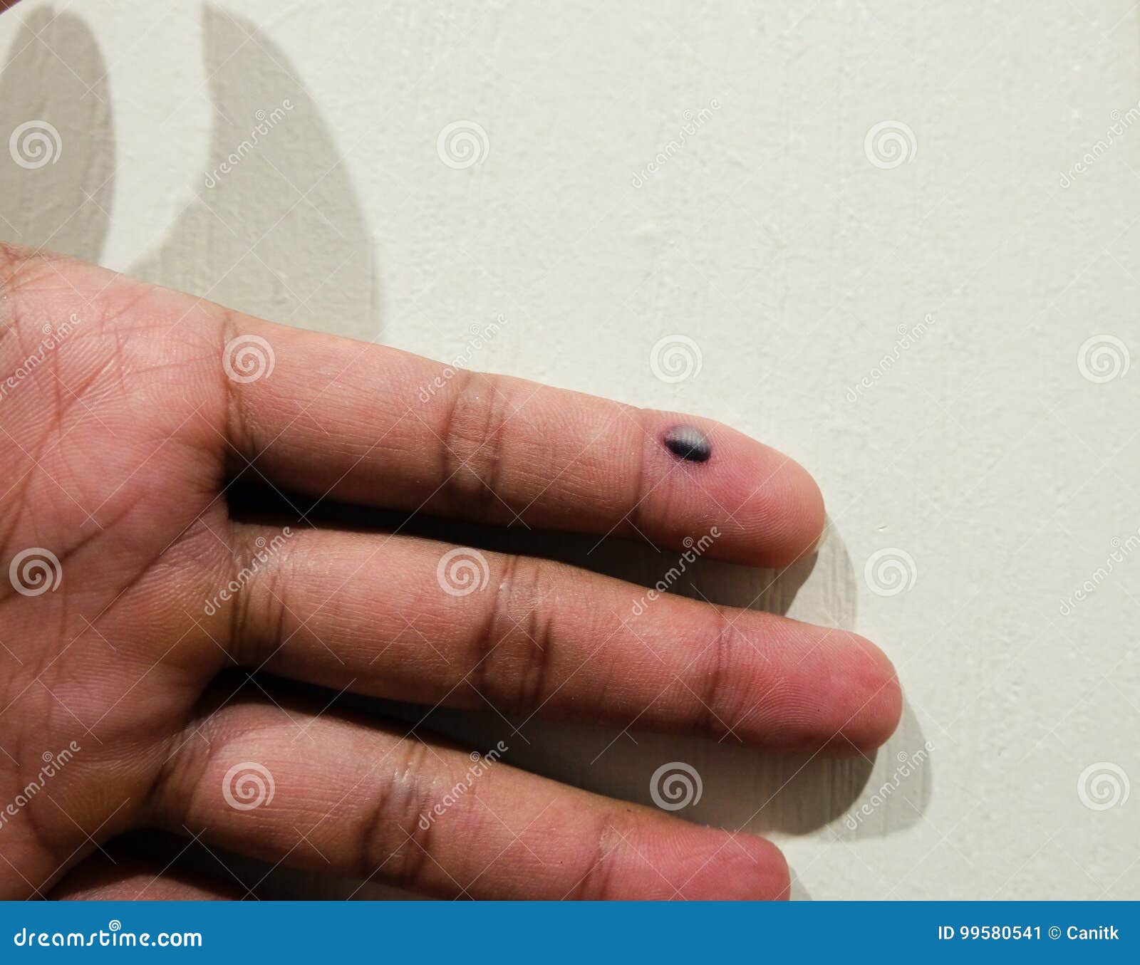 Quetschung im Finger stockbild. Bild von verletzung, verletzt - 99580541