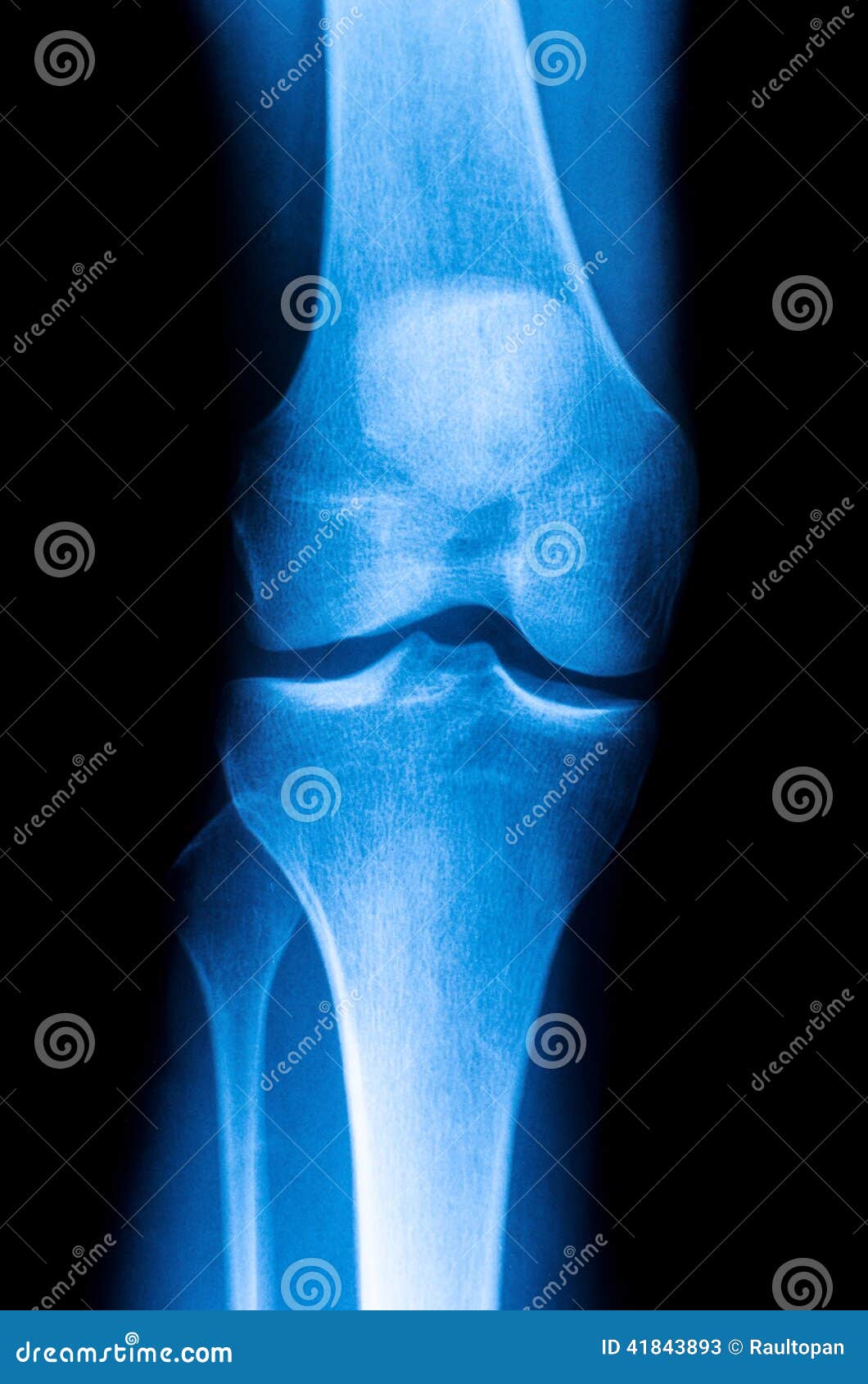 Rótula Alta imagen de archivo. Imagen de rodilla, tibia - 41843893