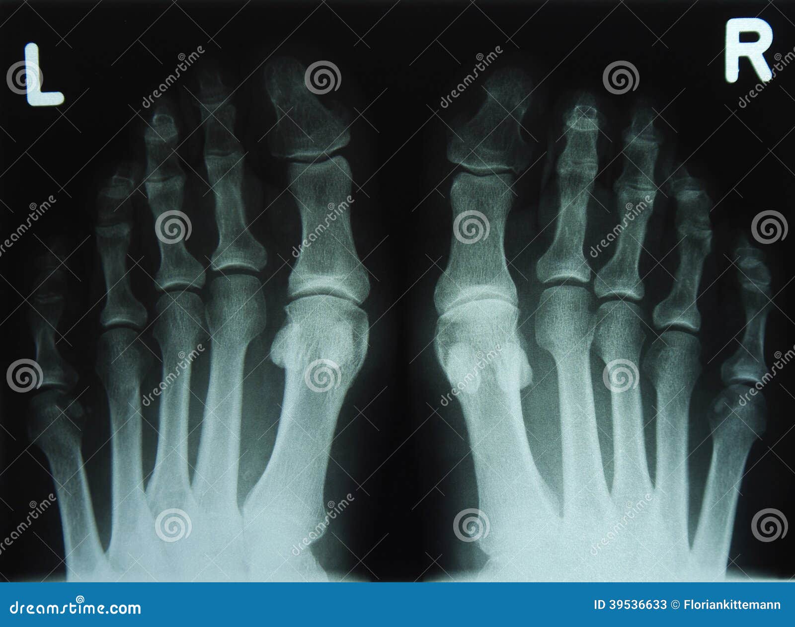 Röntgenbild der Zehen stockbild. Bild von anatomisch - 39536633