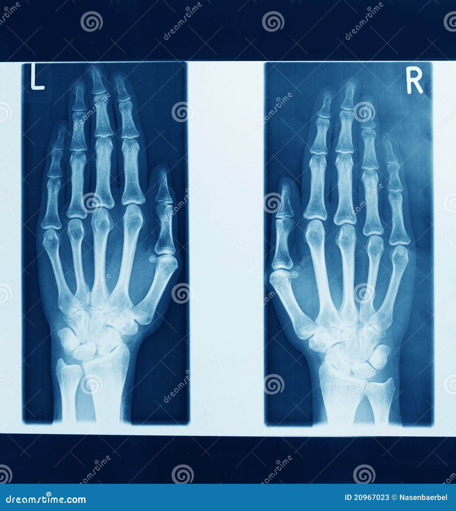 Röntgenfoto Stock Foto's - Afbeelding: 20967023