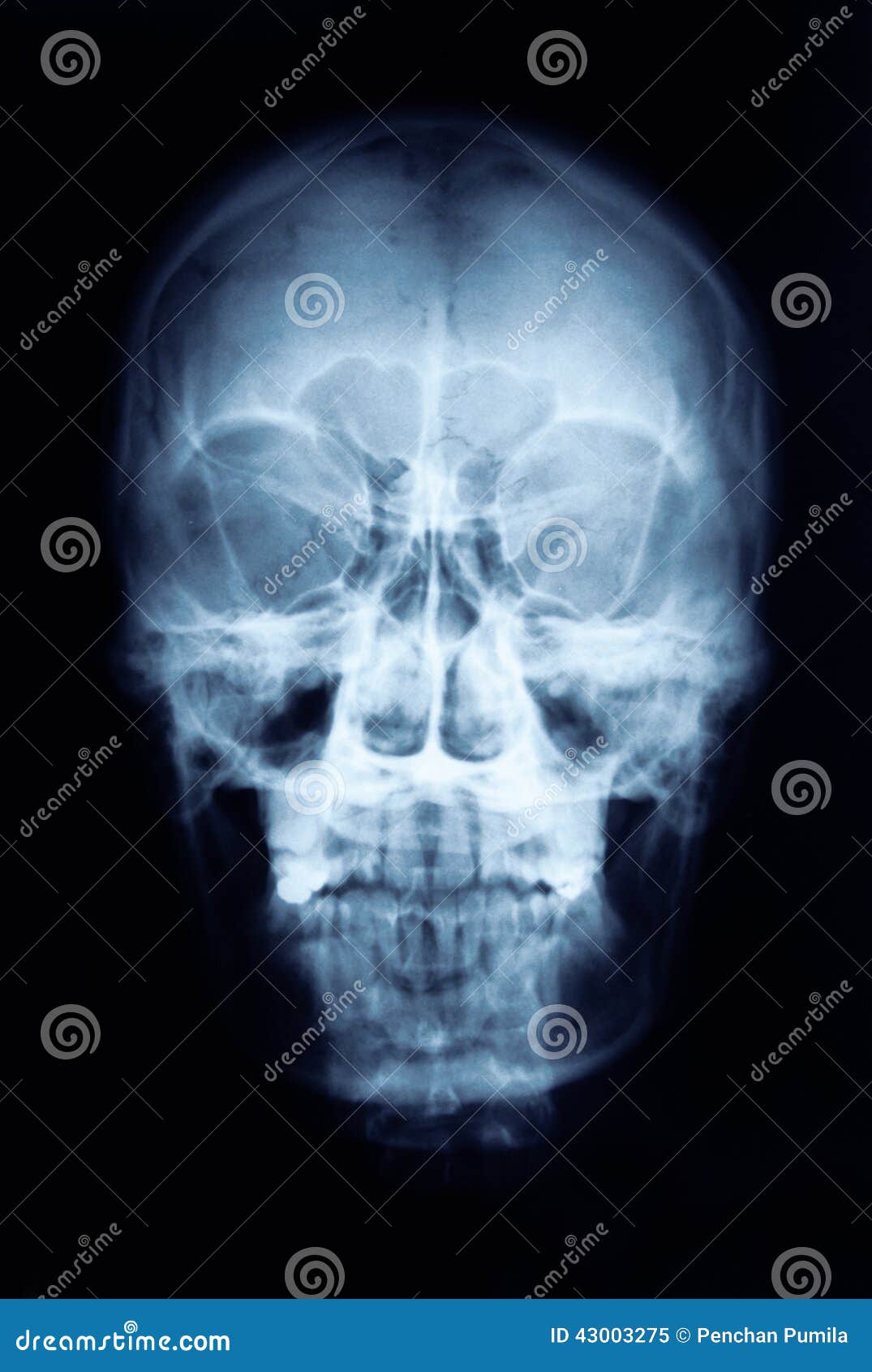 Röntgenfoto van de schedel stock afbeelding. Image of straling - 43003275