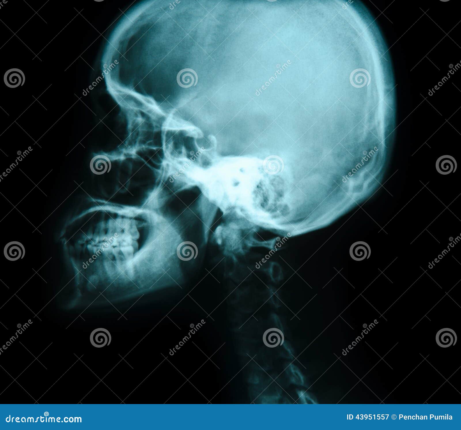 Röntgenfoto van de schedel stock afbeelding. Image of gebied - 43951557