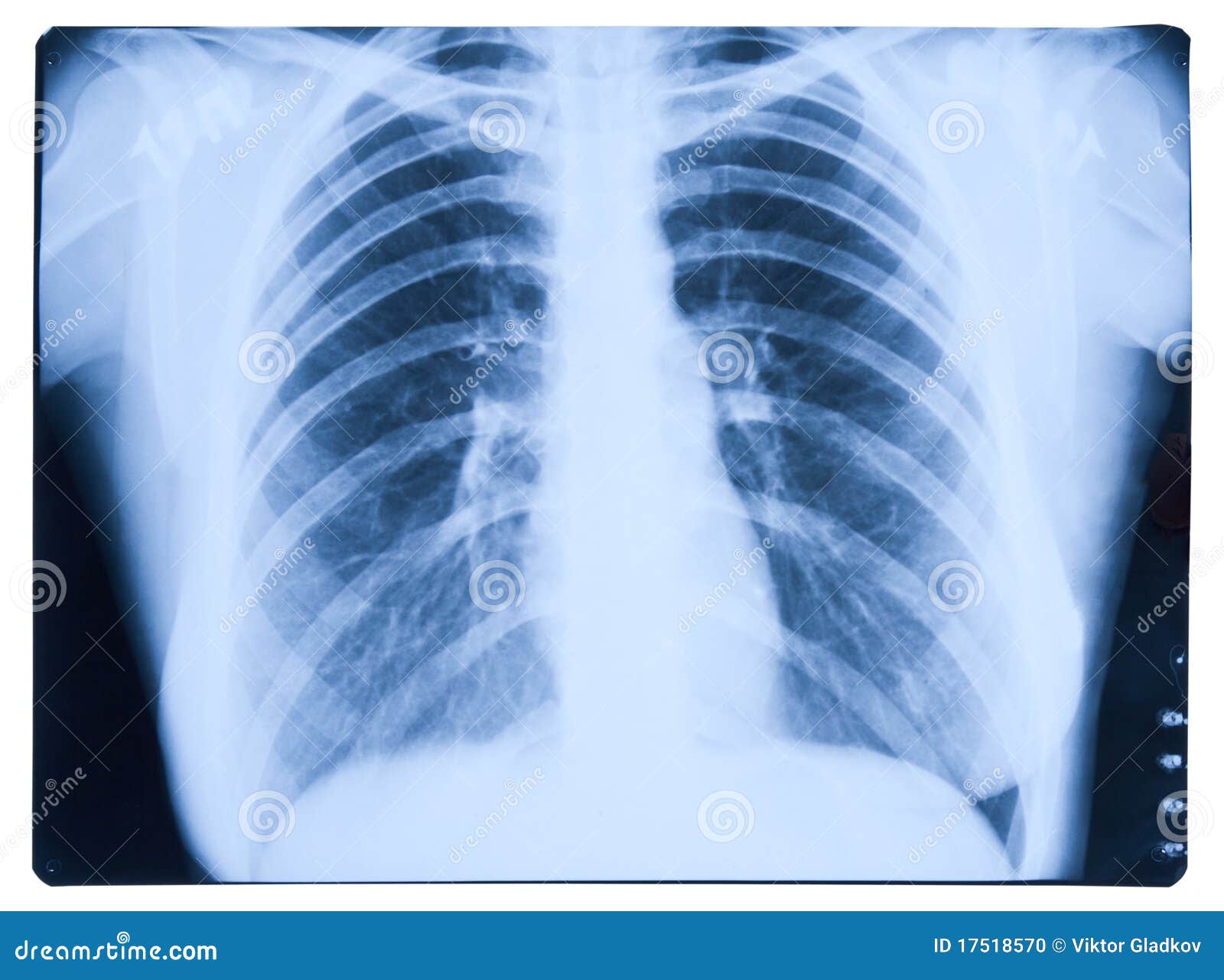 Röntgenfoto Van Longen Stock Foto - Afbeelding: 17518570