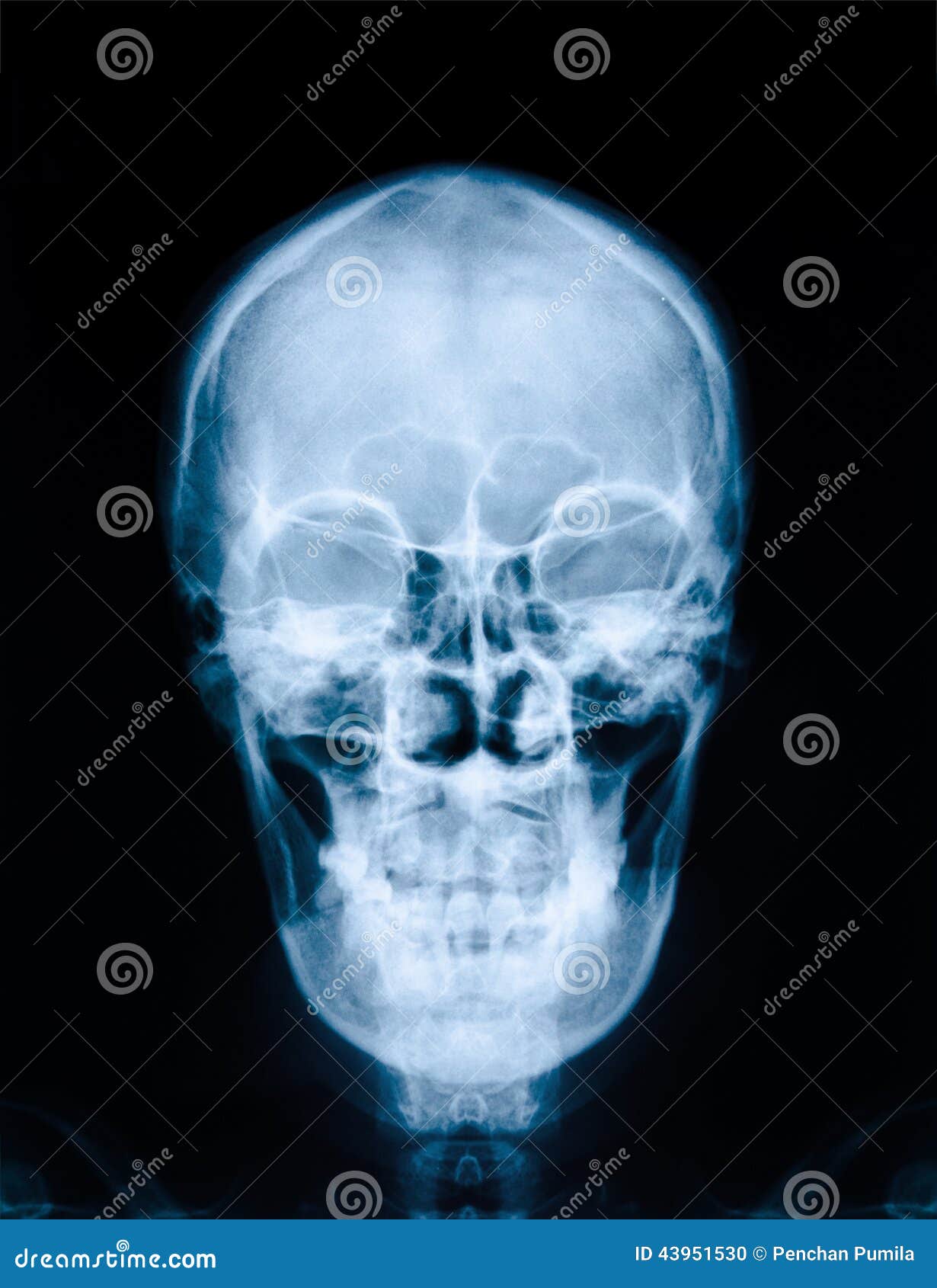 Röntgenfoto van schedel stock foto. Image of anatomie - 43951530
