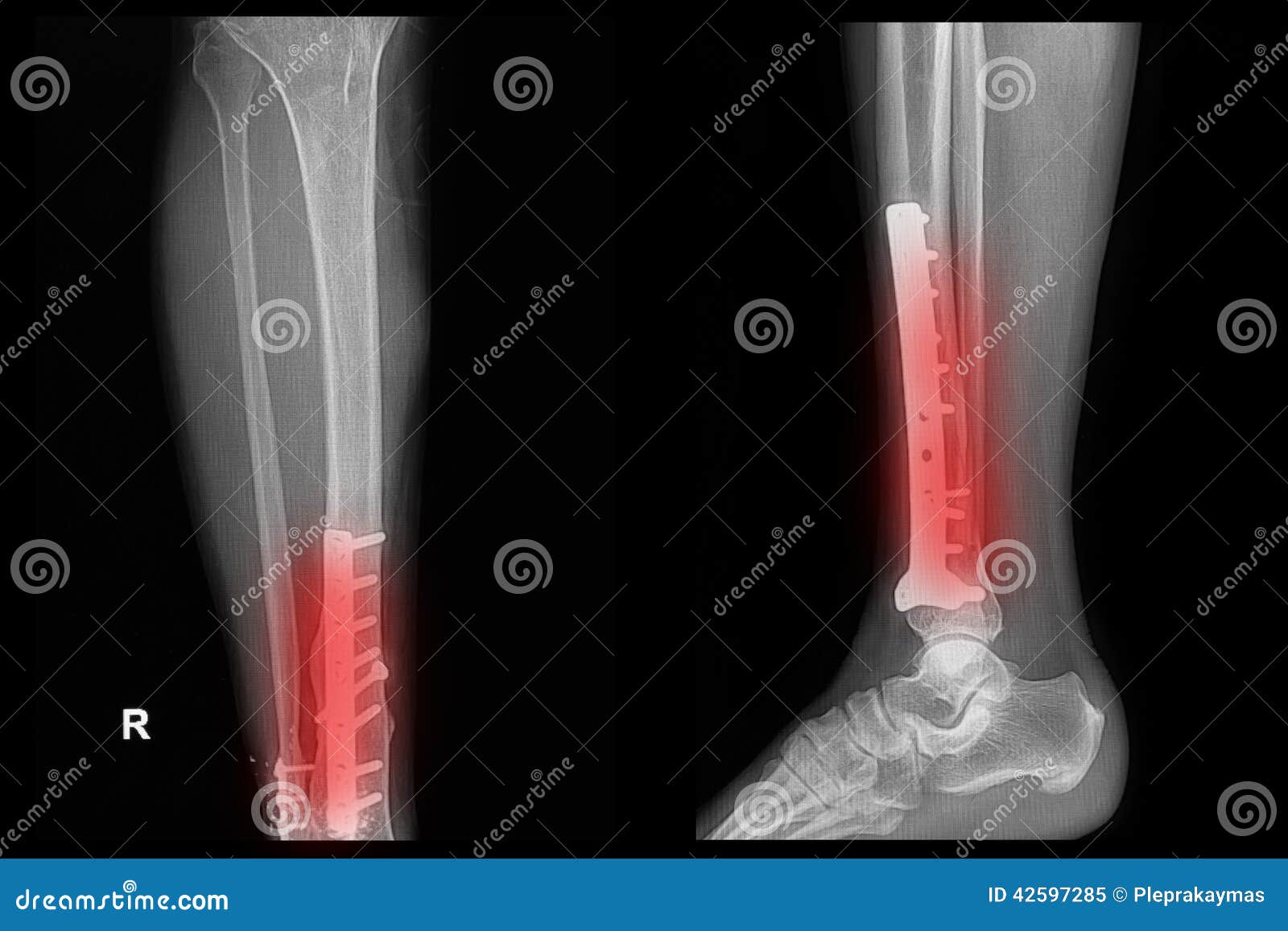 Röntgenstraalbeeld Van Breukbeen (scheenbeen) Stock Afbeelding - Image ...