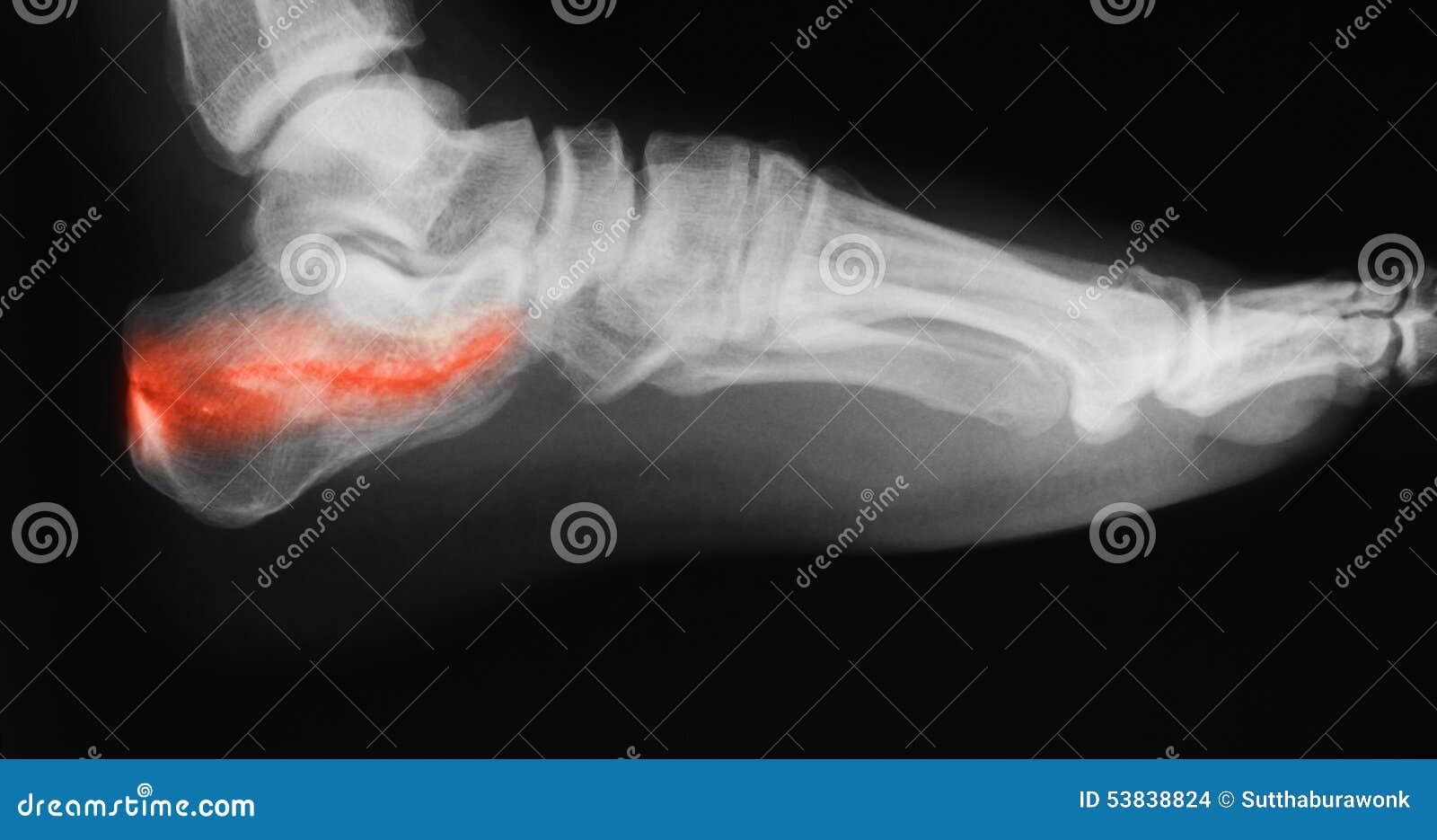 Röntgenstraalbeeld Van Gebroken Hiel Stock Foto - Image of hiel ...