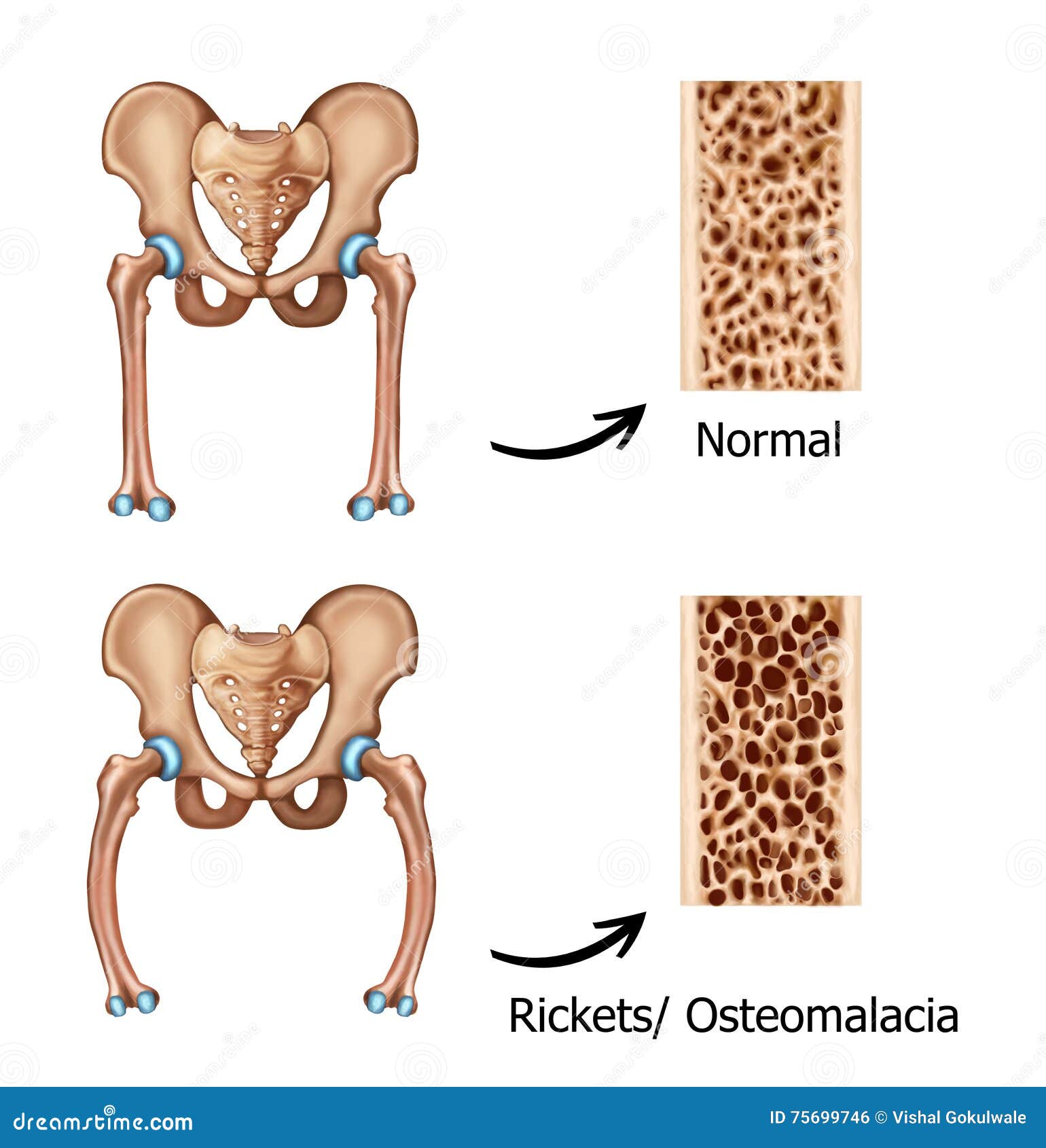Rachitis-Osteomalazie stock abbildung. Illustration von schenkelbein ...