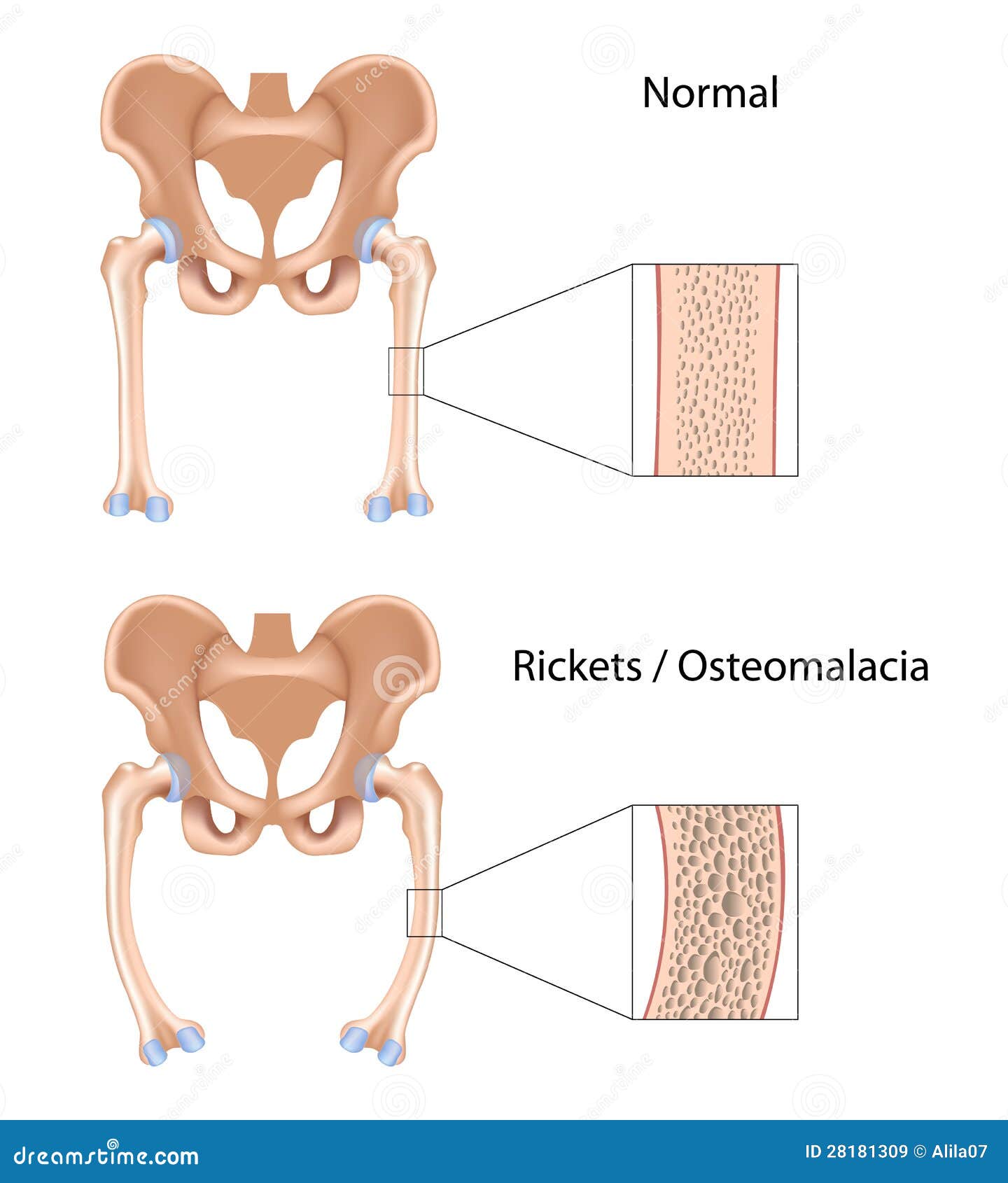 Rachitis und Osteomalazie vektor abbildung. Illustration von gesund - 28181309