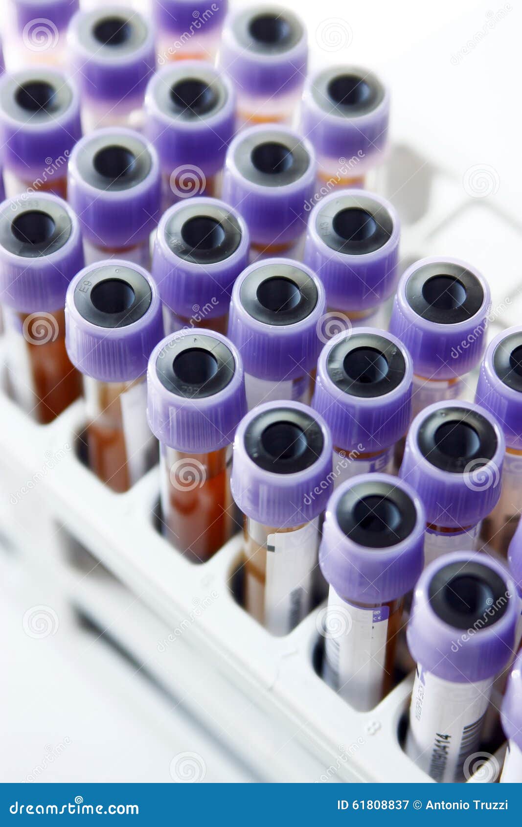 Rack with Test Tubes of Blood Stock Image - Image of nurse, science ...