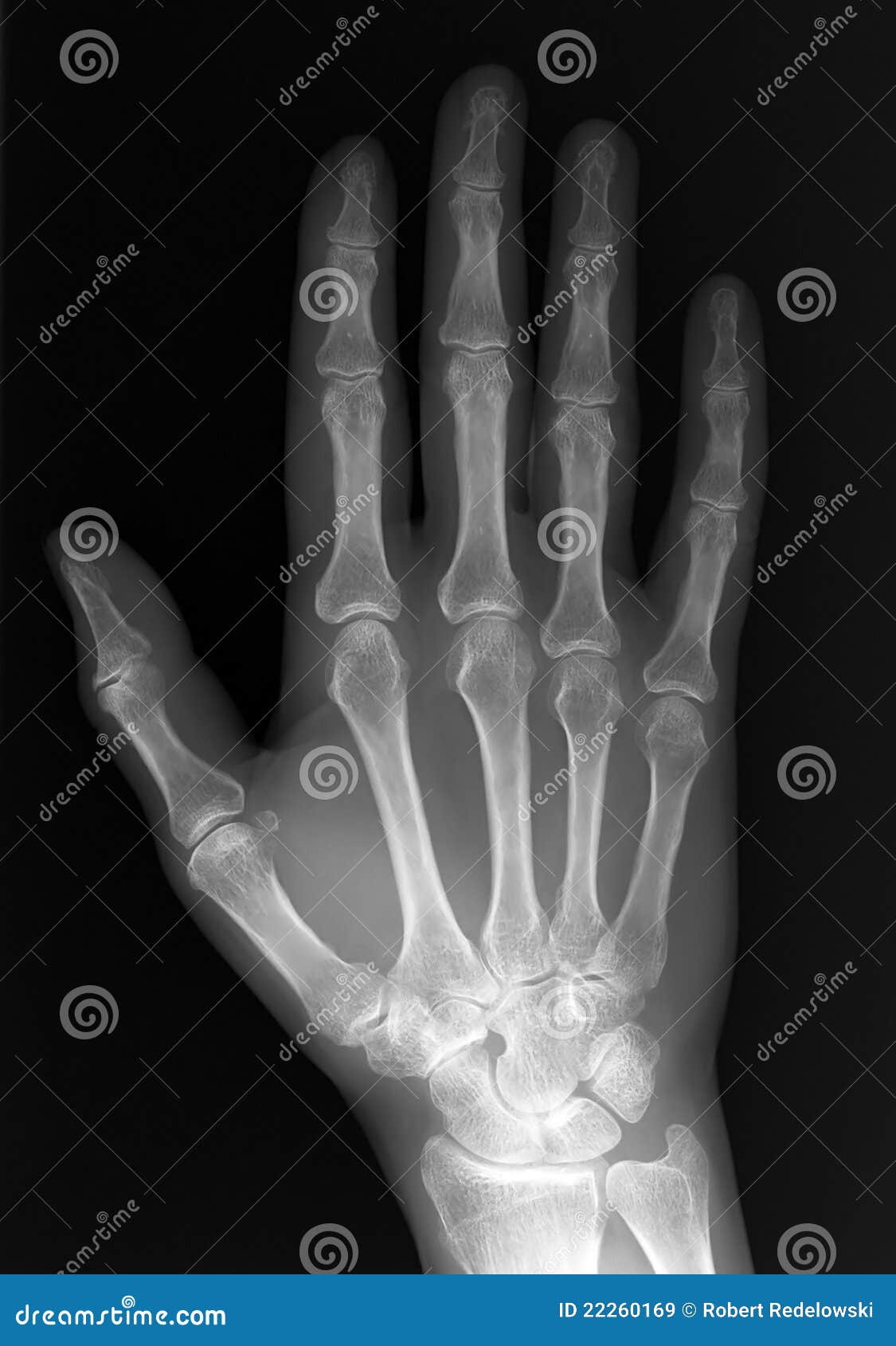Radiografía de la mano imagen de archivo. Imagen de radio - 22260169