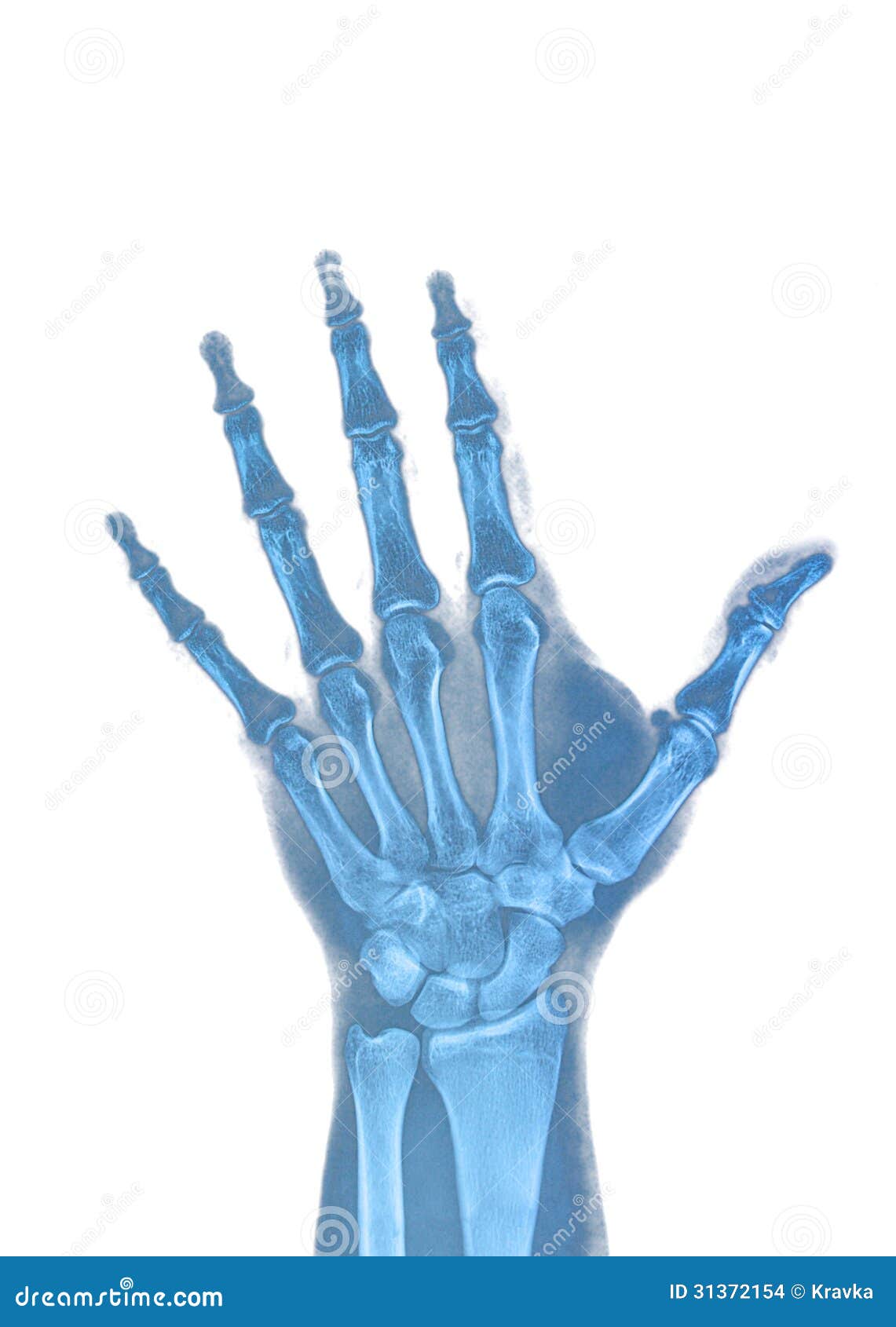 Radiografía de la mano foto de archivo. Imagen de humano - 31372154