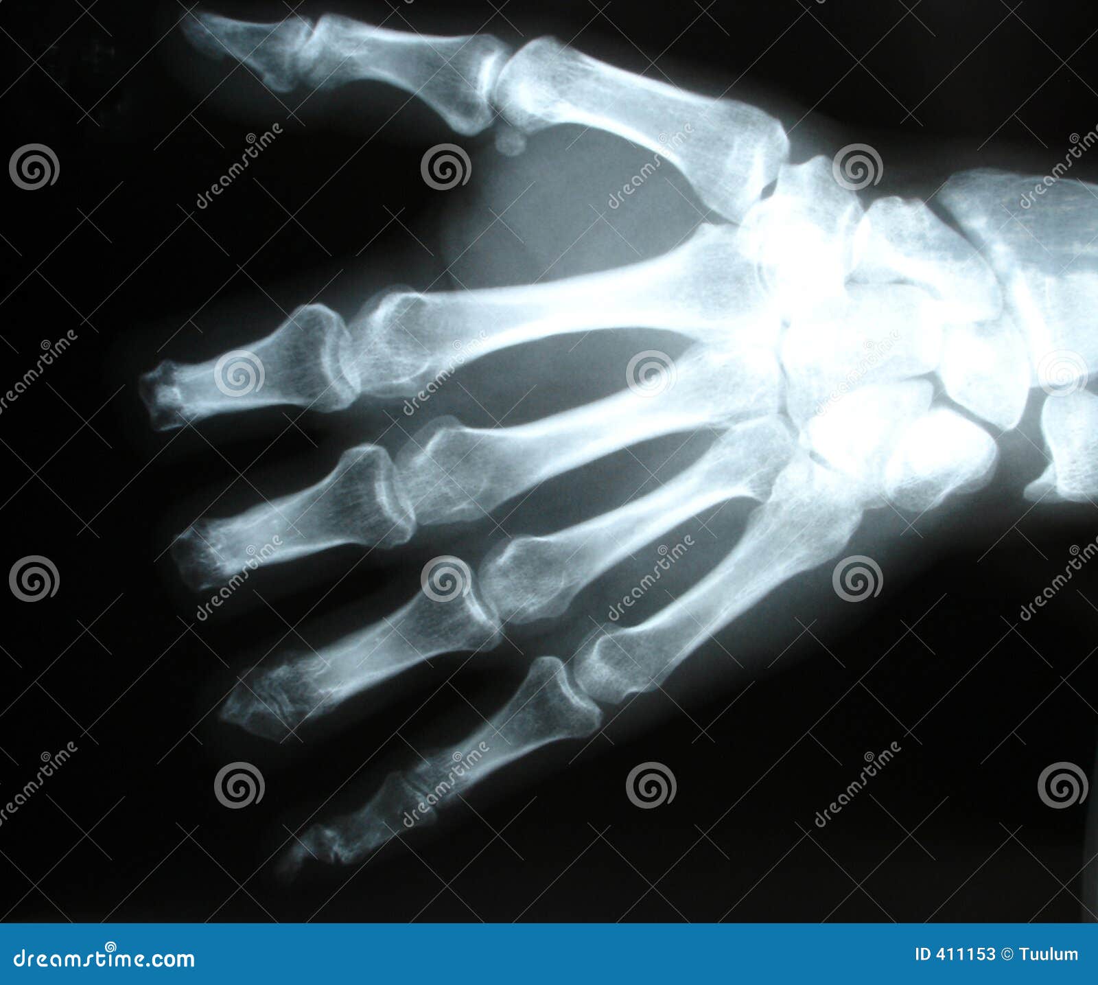 Radiografía de la mano imagen de archivo. Imagen de rotura - 411153