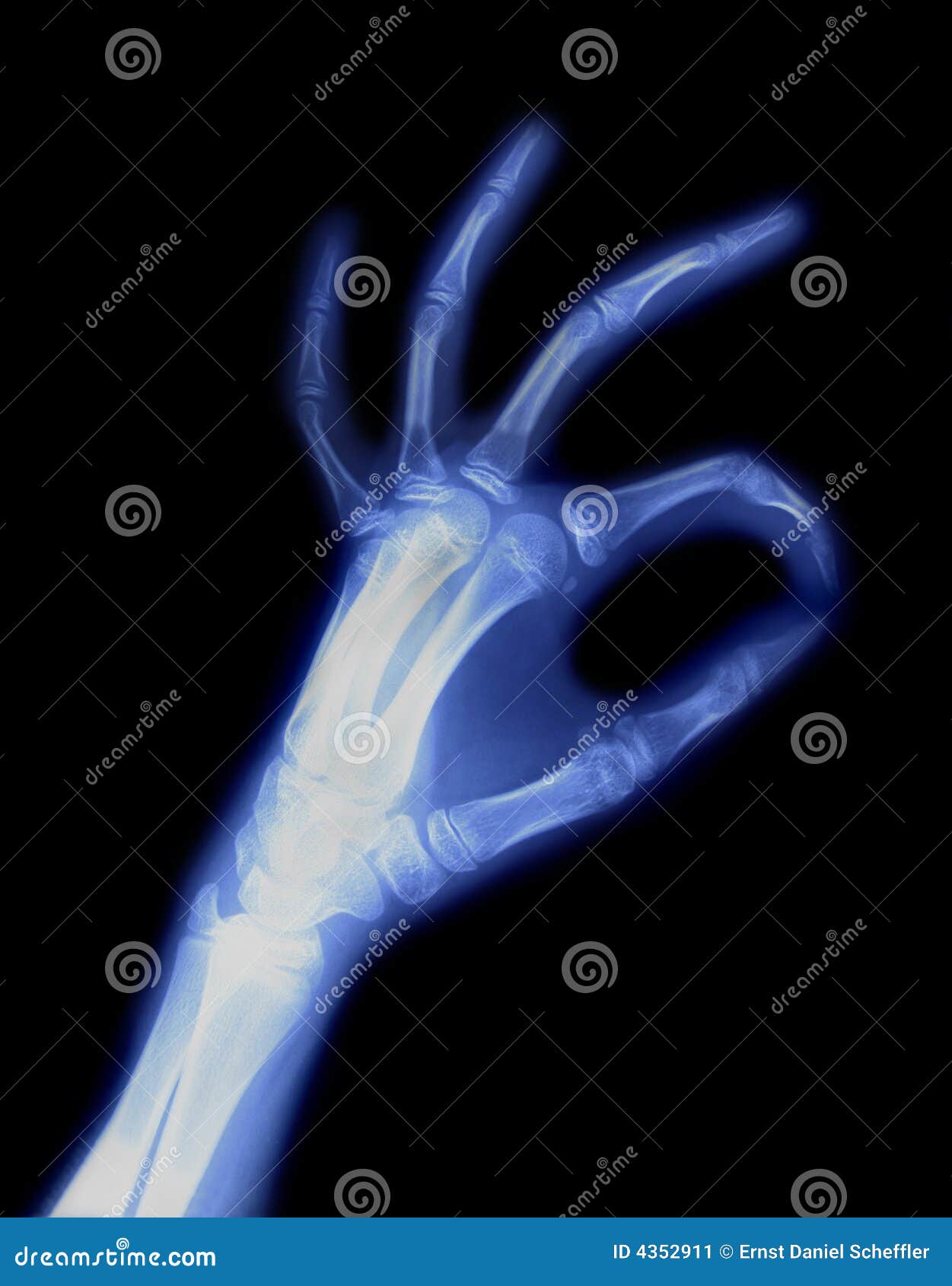 Radiografía de la mano imagen de archivo. Imagen de roentgen - 4352911
