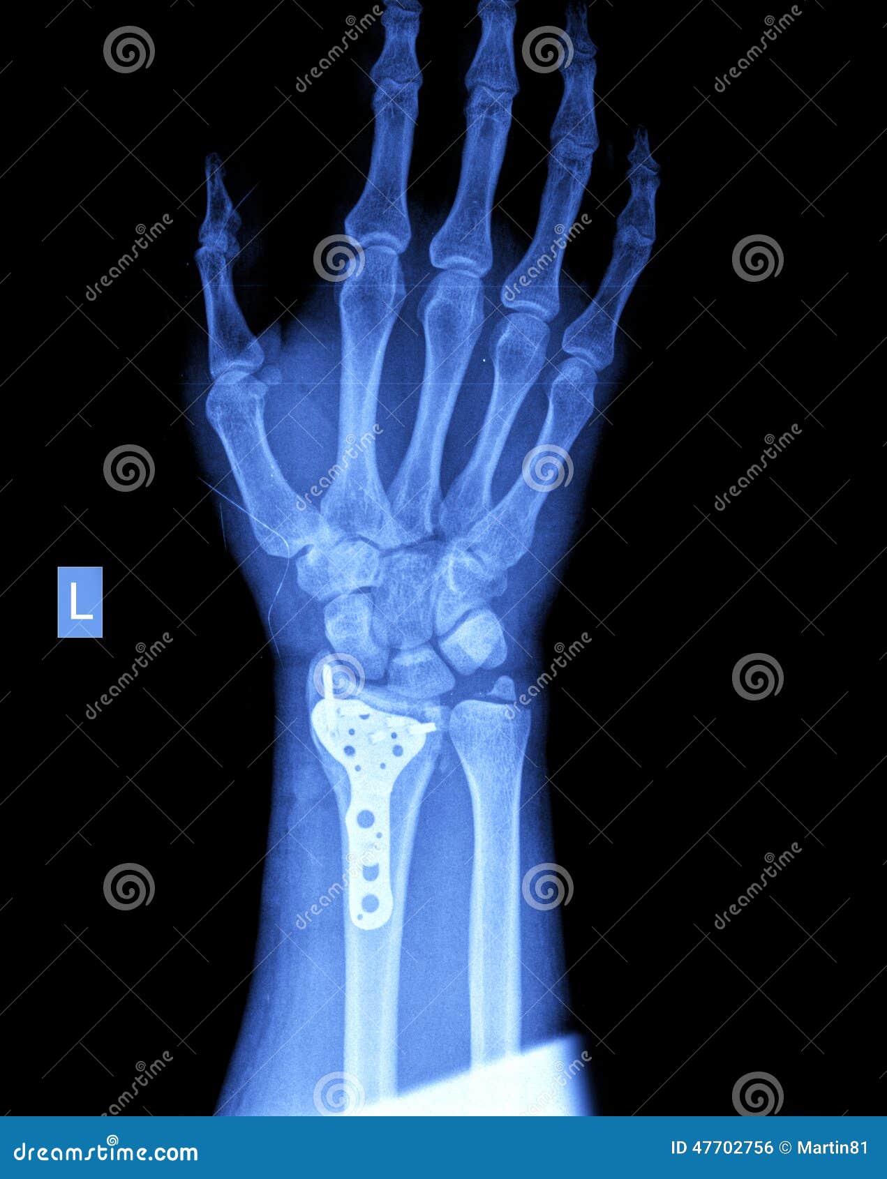 Radiografía de la mano foto de archivo. Imagen de junta - 47702756