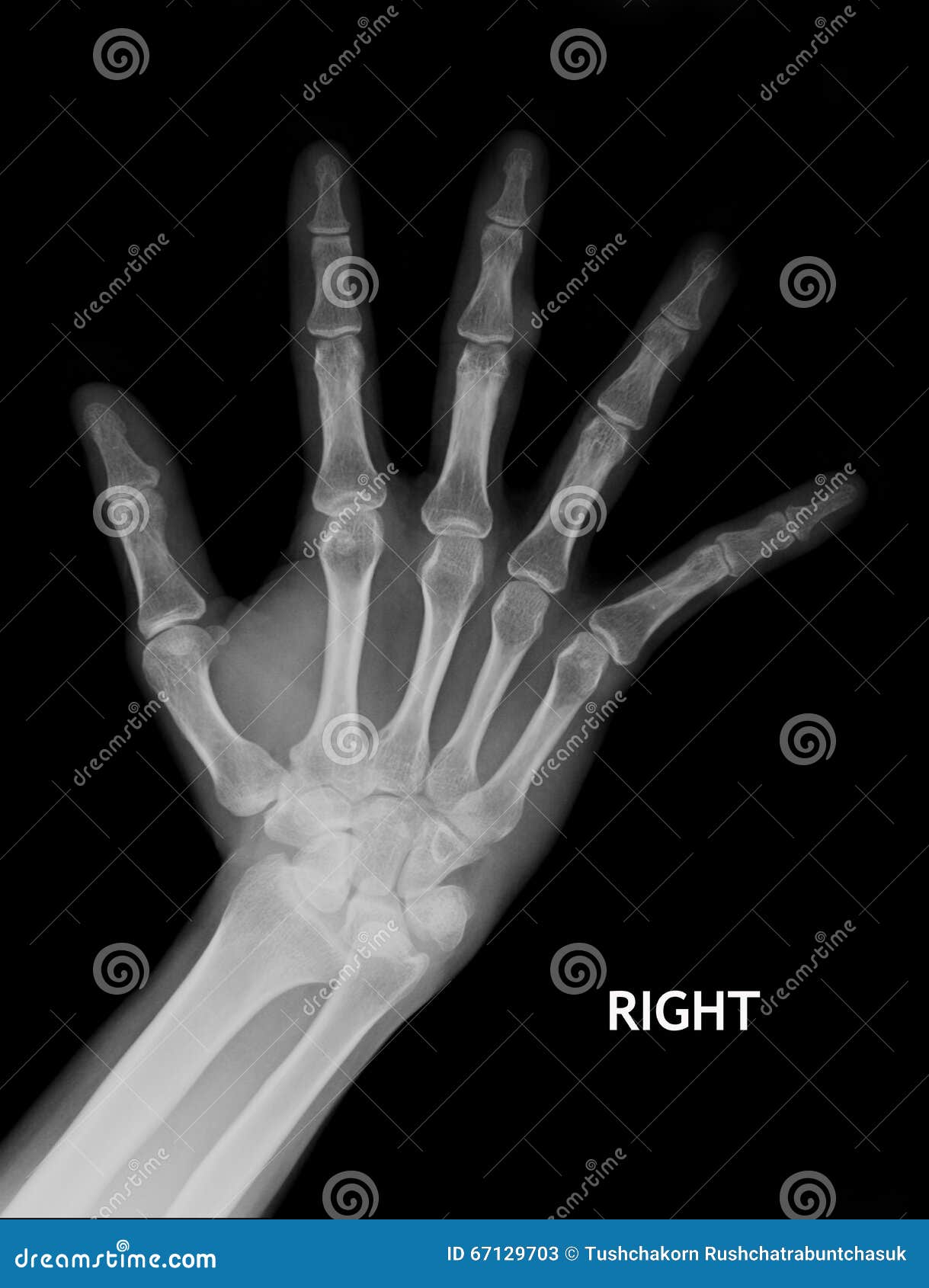 Radiografía de la mano imagen de archivo. Imagen de roentgen - 67129703