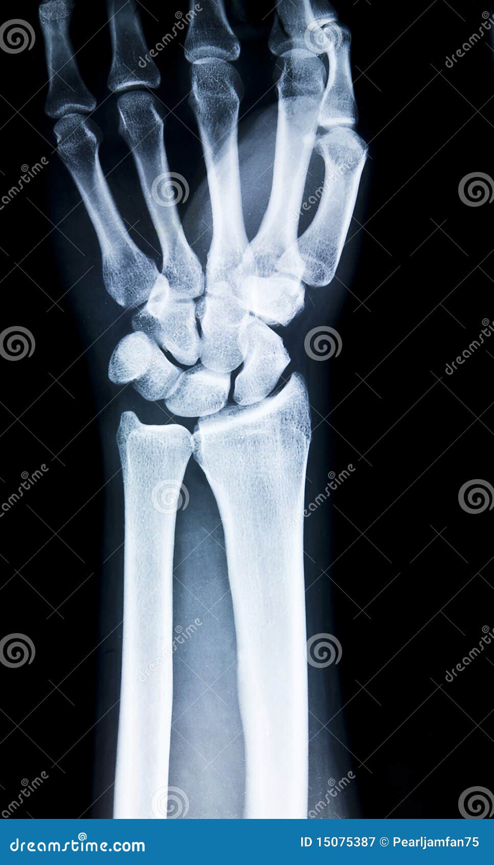 Radiografía De La Mano Izquierda Imagen de archivo - Imagen de mano ...