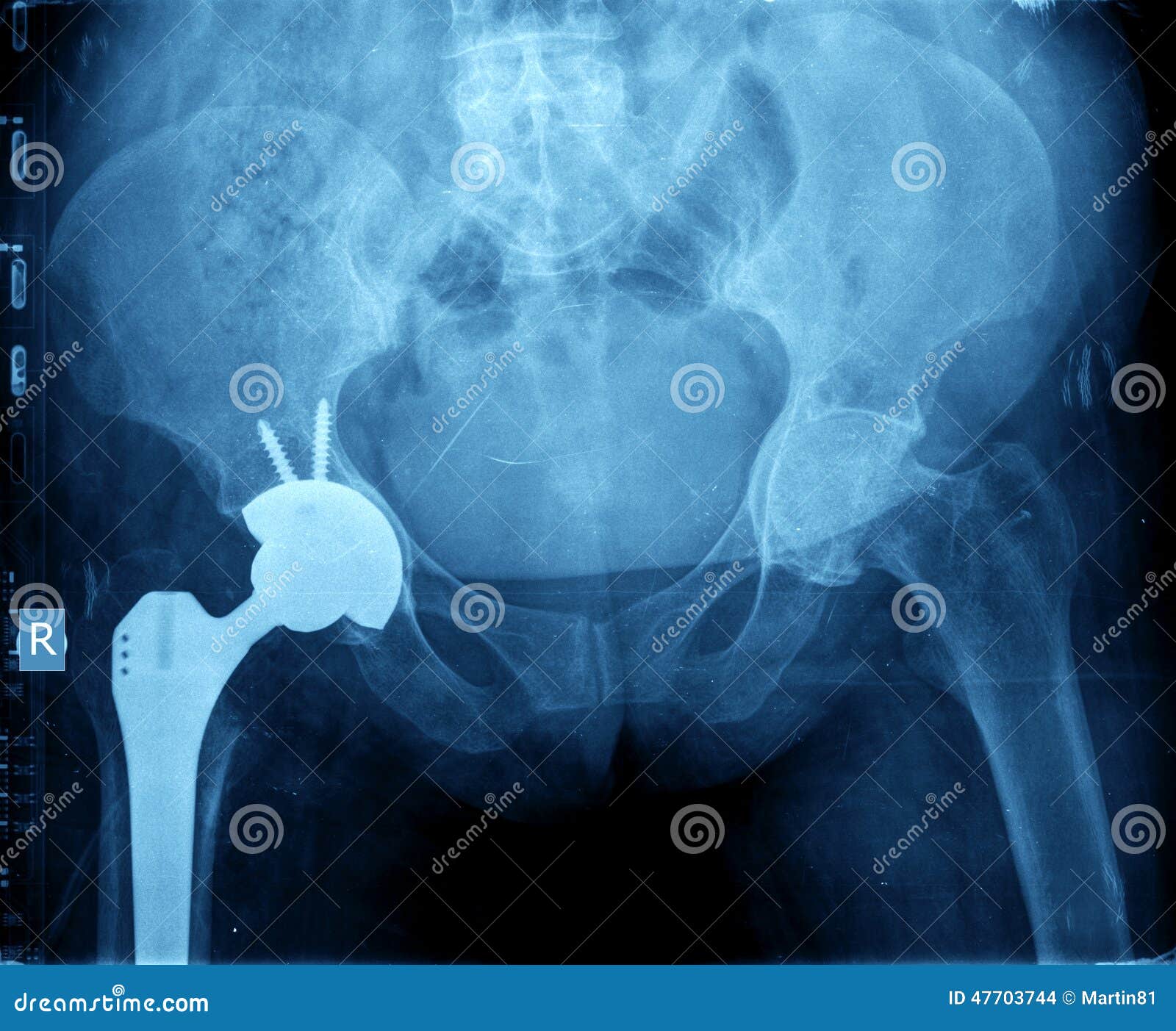 Radiografía De La Prótesis De La Cadera Foto de archivo - Imagen de ...