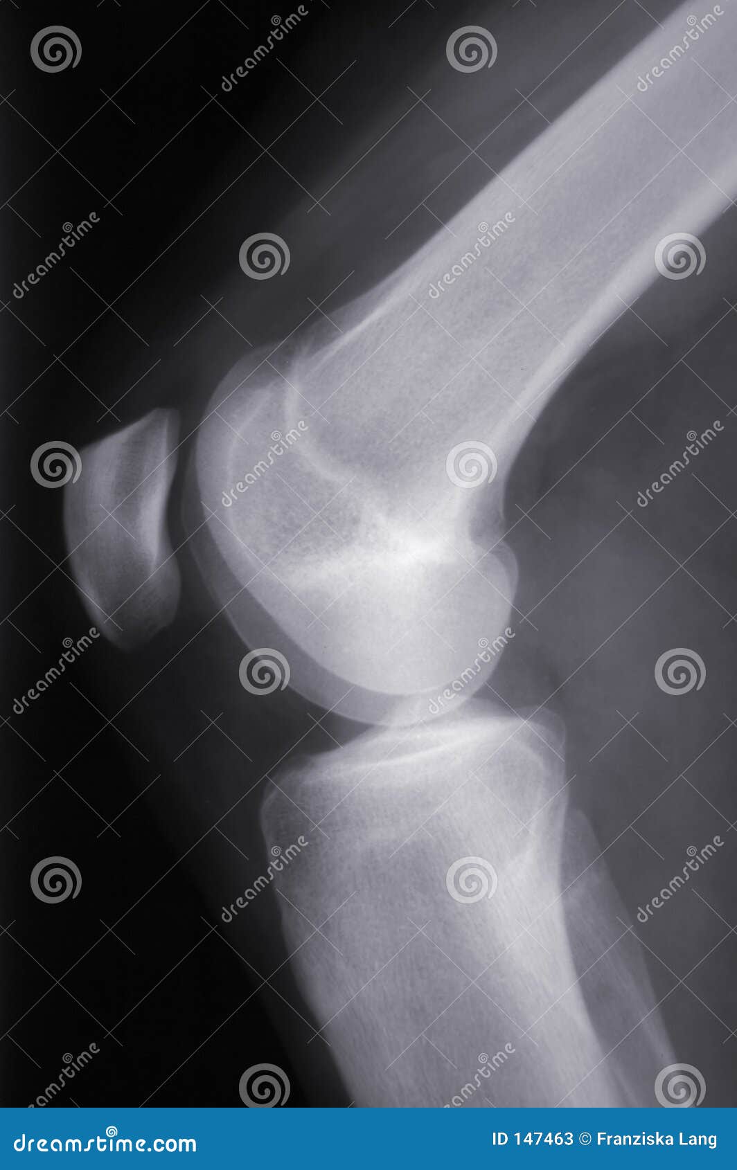 Radiografía de la rodilla