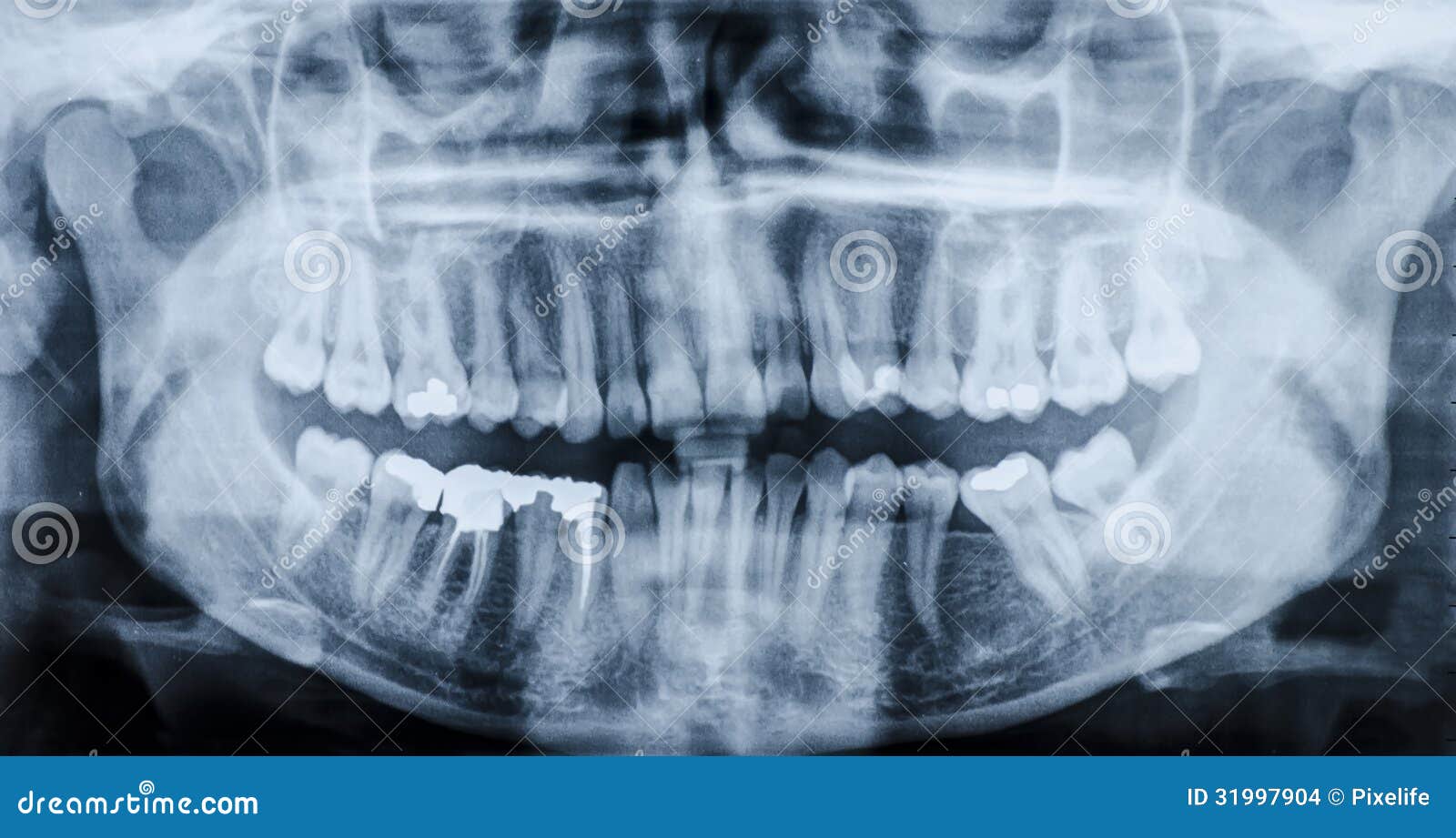 Radiografía de los dientes foto de archivo. Imagen de azul - 31997904