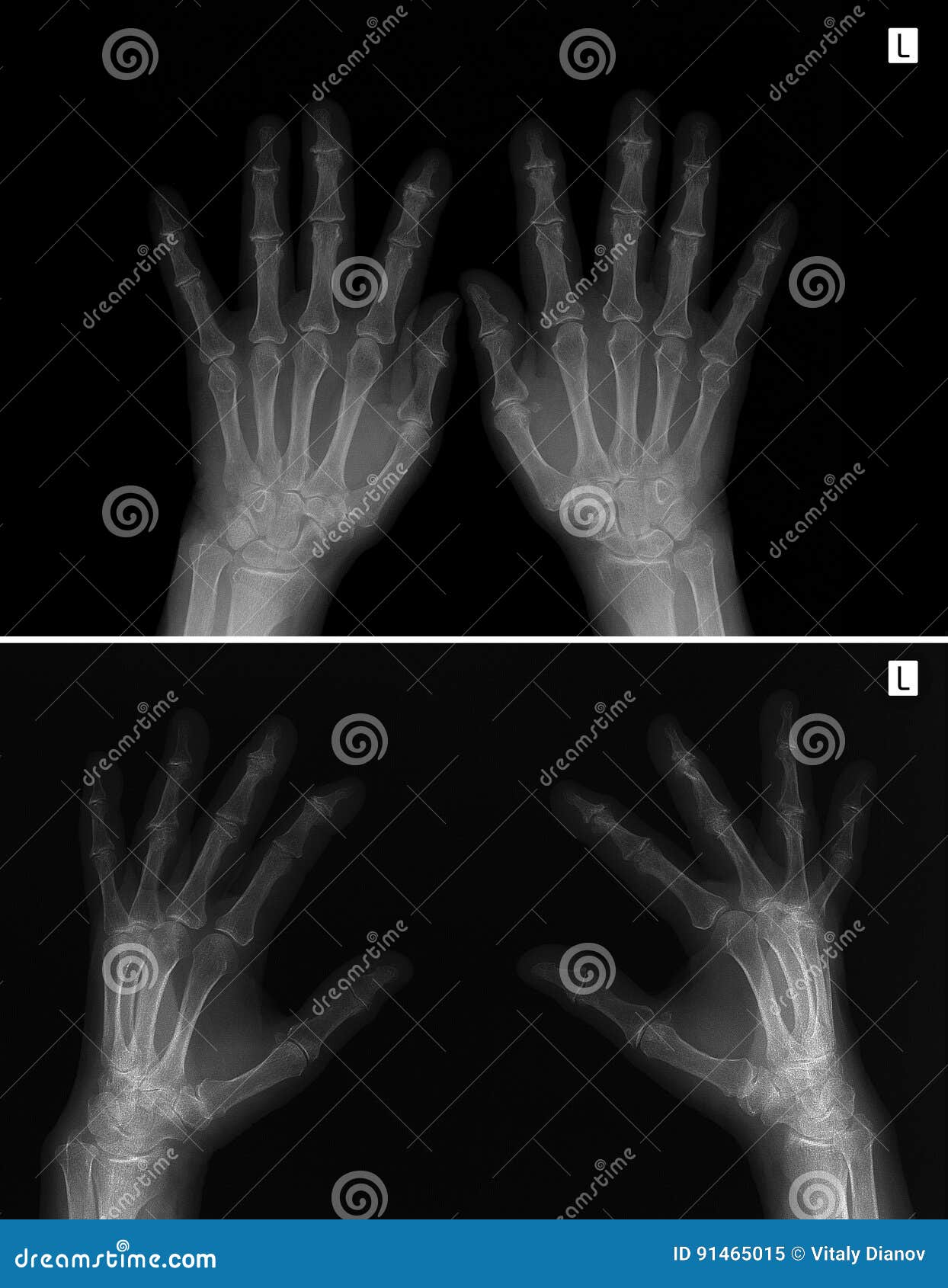 Radiografía De Manos Artritis-artrosis Imagen de archivo - Imagen de ...