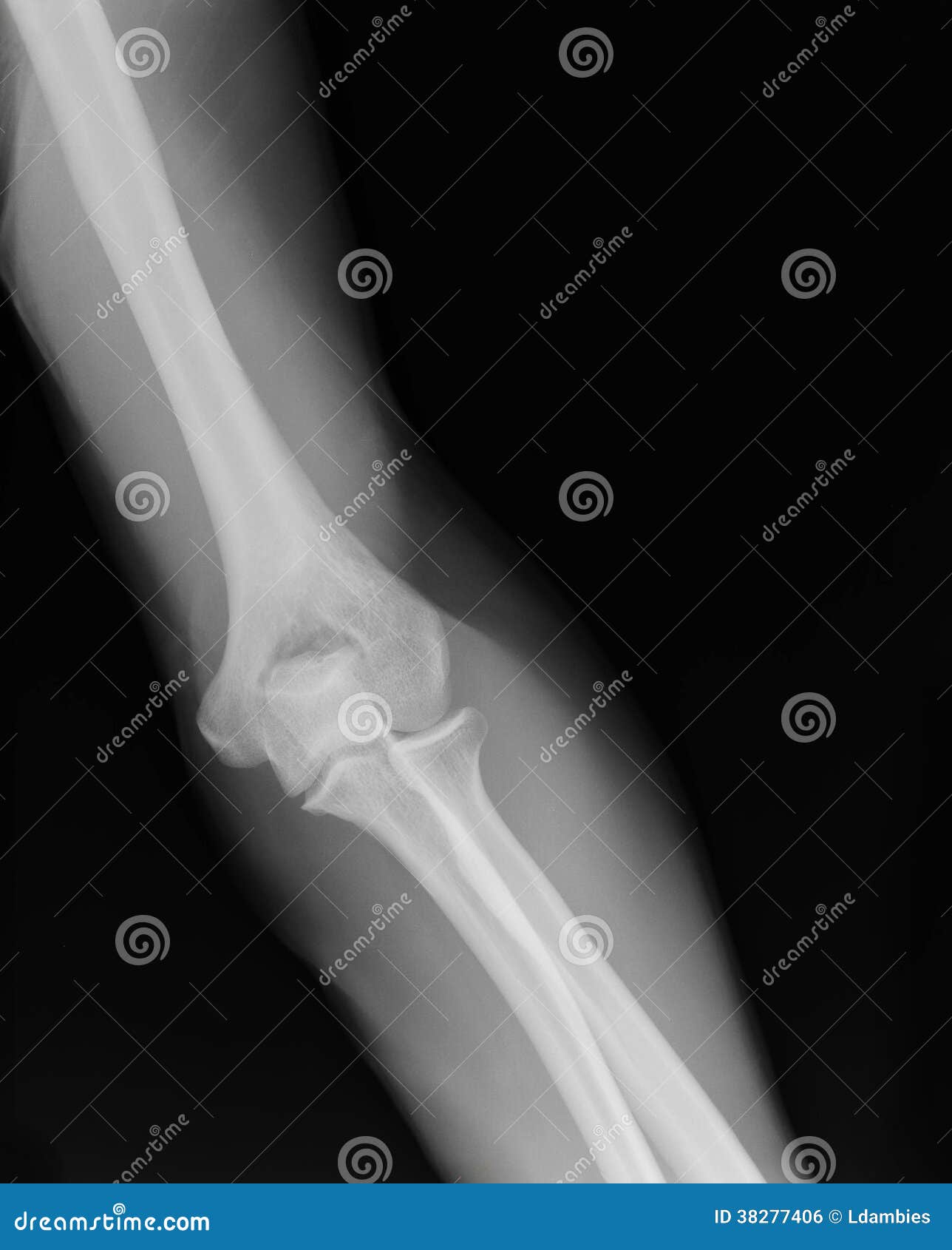 Radiografía del brazo foto de archivo. Imagen de esqueleto - 38277406