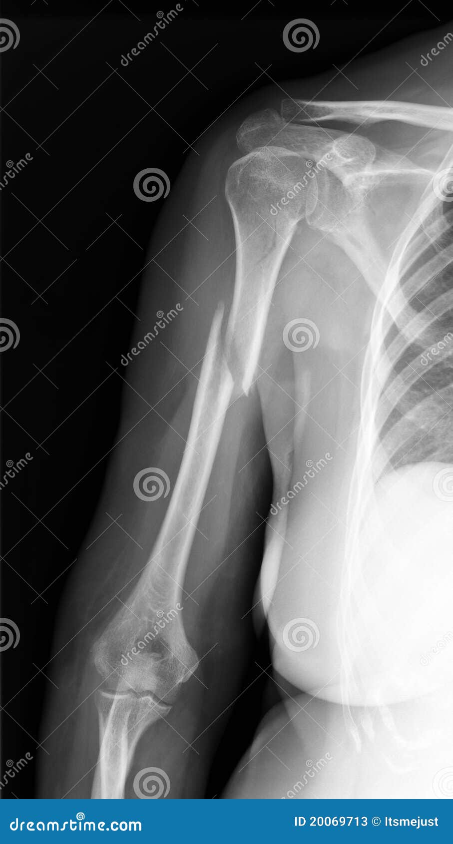 Radiografía Del Brazo Quebrado. Imagen de archivo - Imagen de doloroso ...