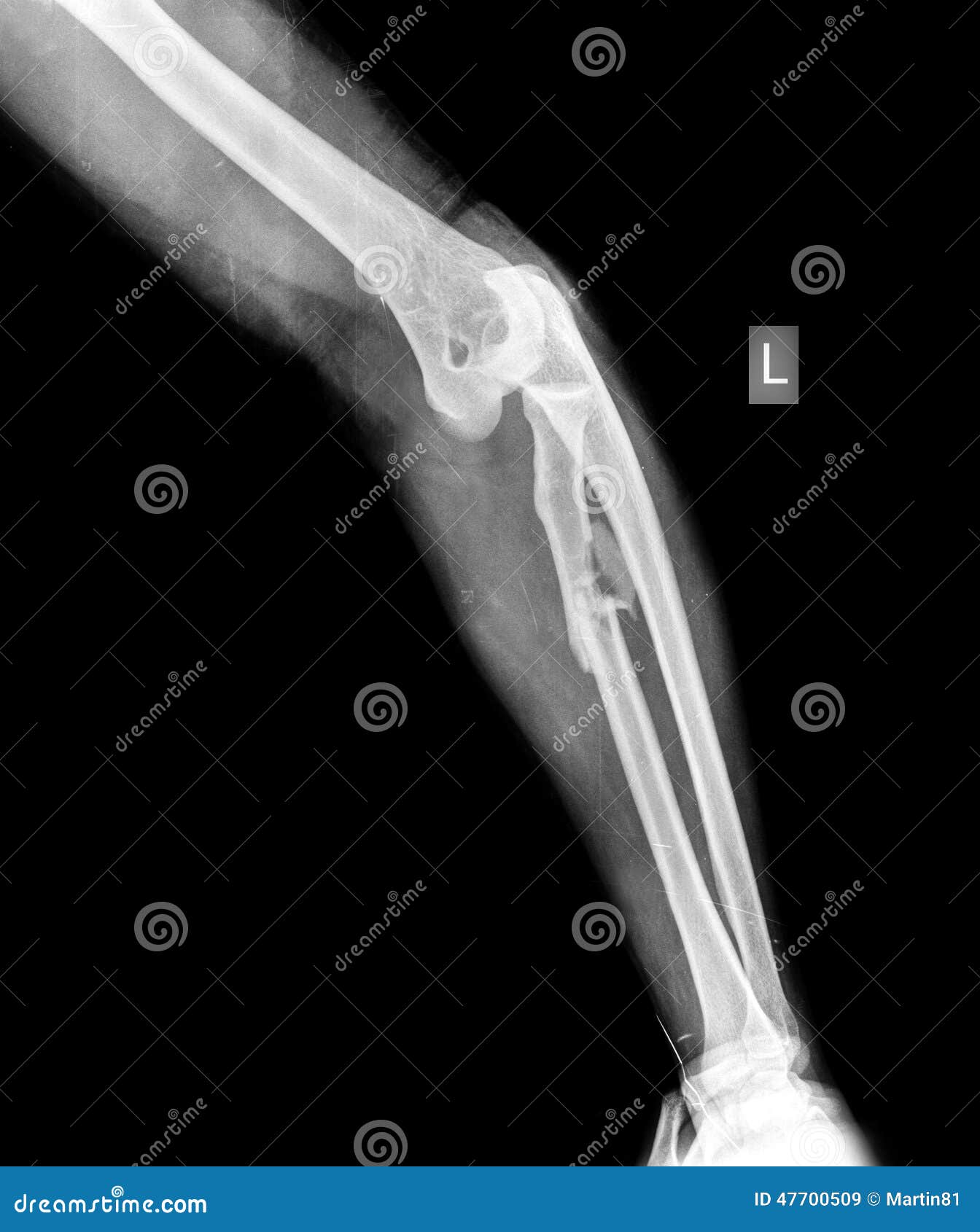 Radiografía Del Brazo Quebrado Imagen de archivo - Imagen de cierre ...