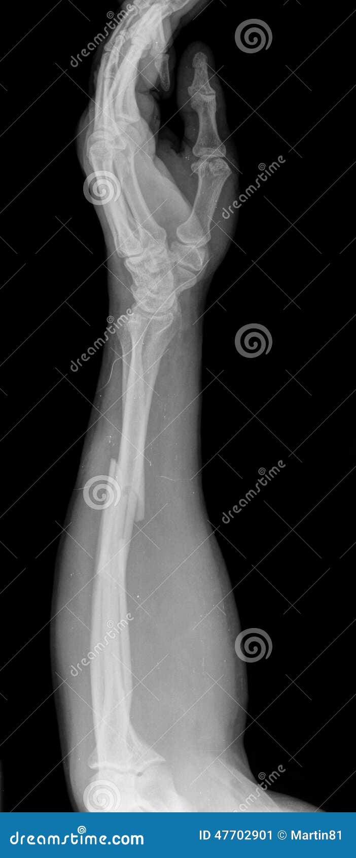 Radiografía Del Brazo Quebrado Imagen de archivo - Imagen de roto ...
