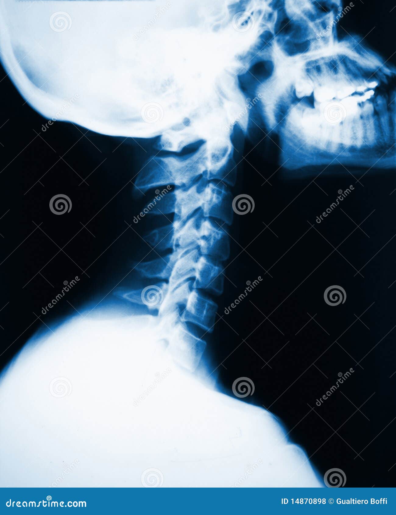 Radiografía del cuello foto de archivo. Imagen de ciencia - 14870898