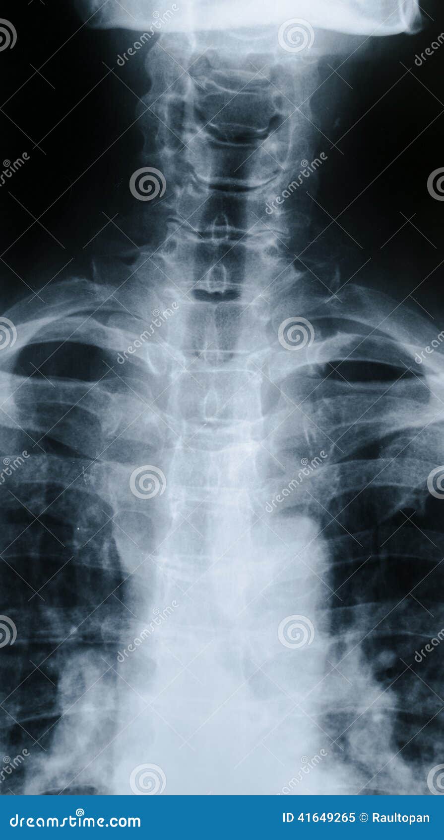Radiografía del cuello imagen de archivo. Imagen de cervical - 41649265