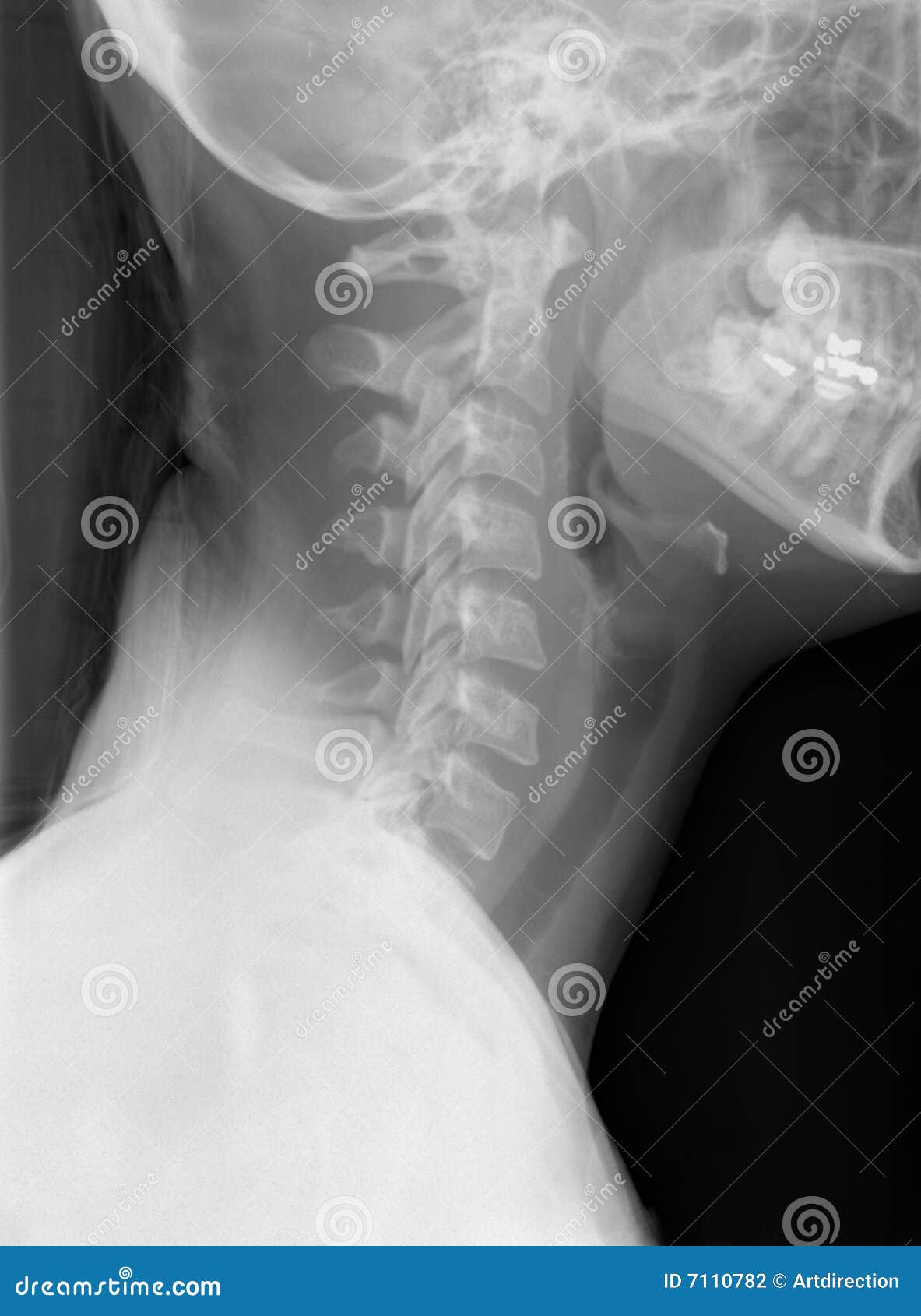 Radiografía del cuello foto de archivo. Imagen de quijada - 7110782