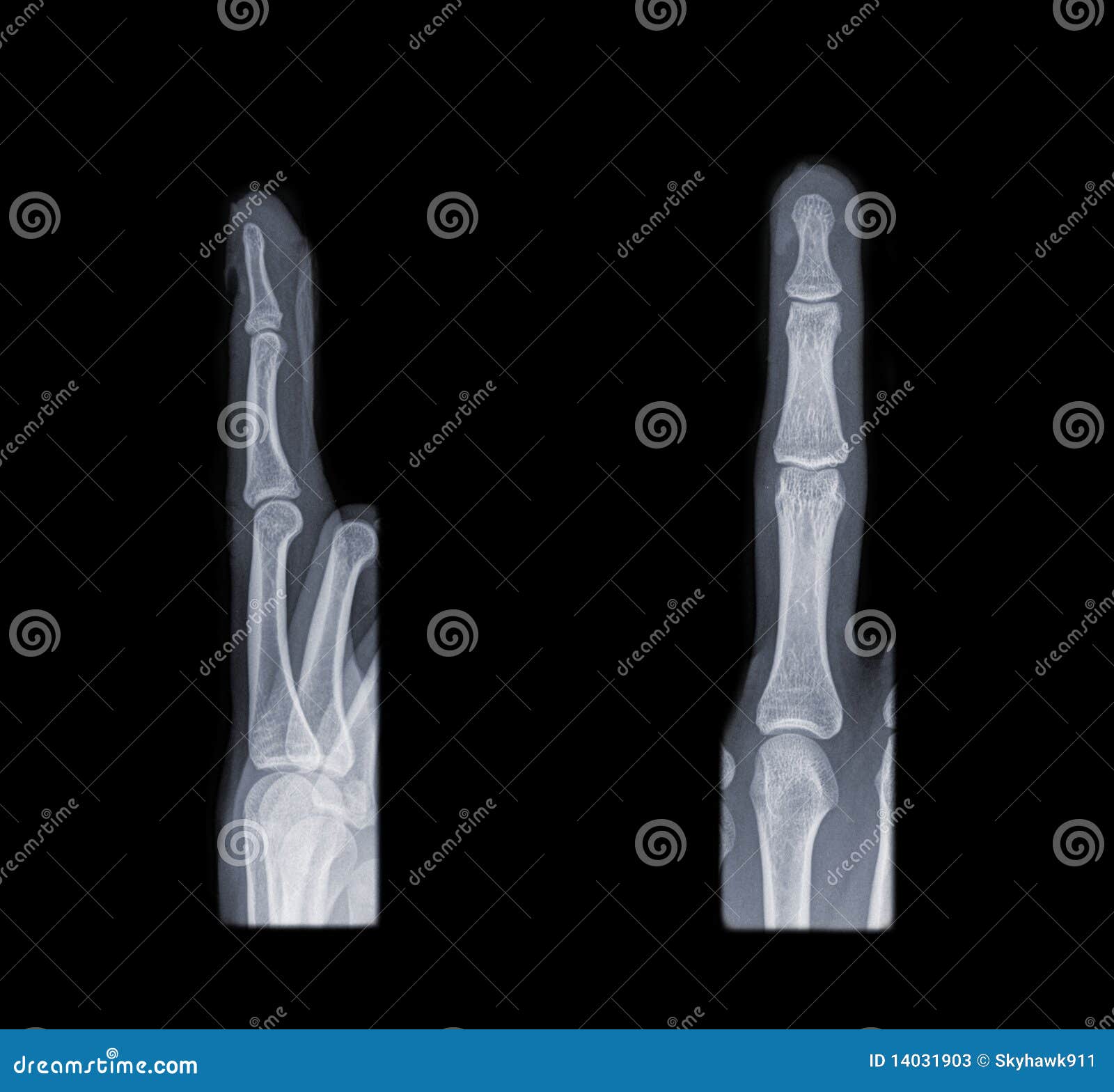 Radiografía del dedo imagen de archivo. Imagen de hospital - 14031903