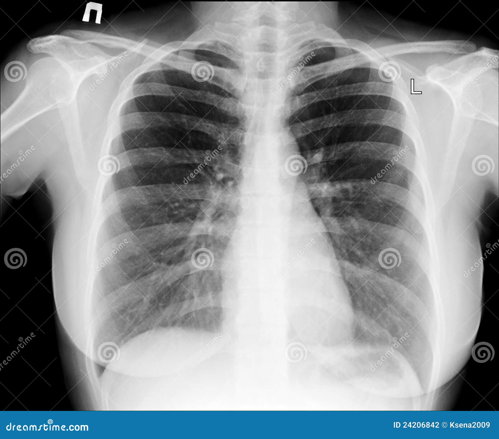 Radiografía del pecho foto de archivo. Imagen de humano - 24206842